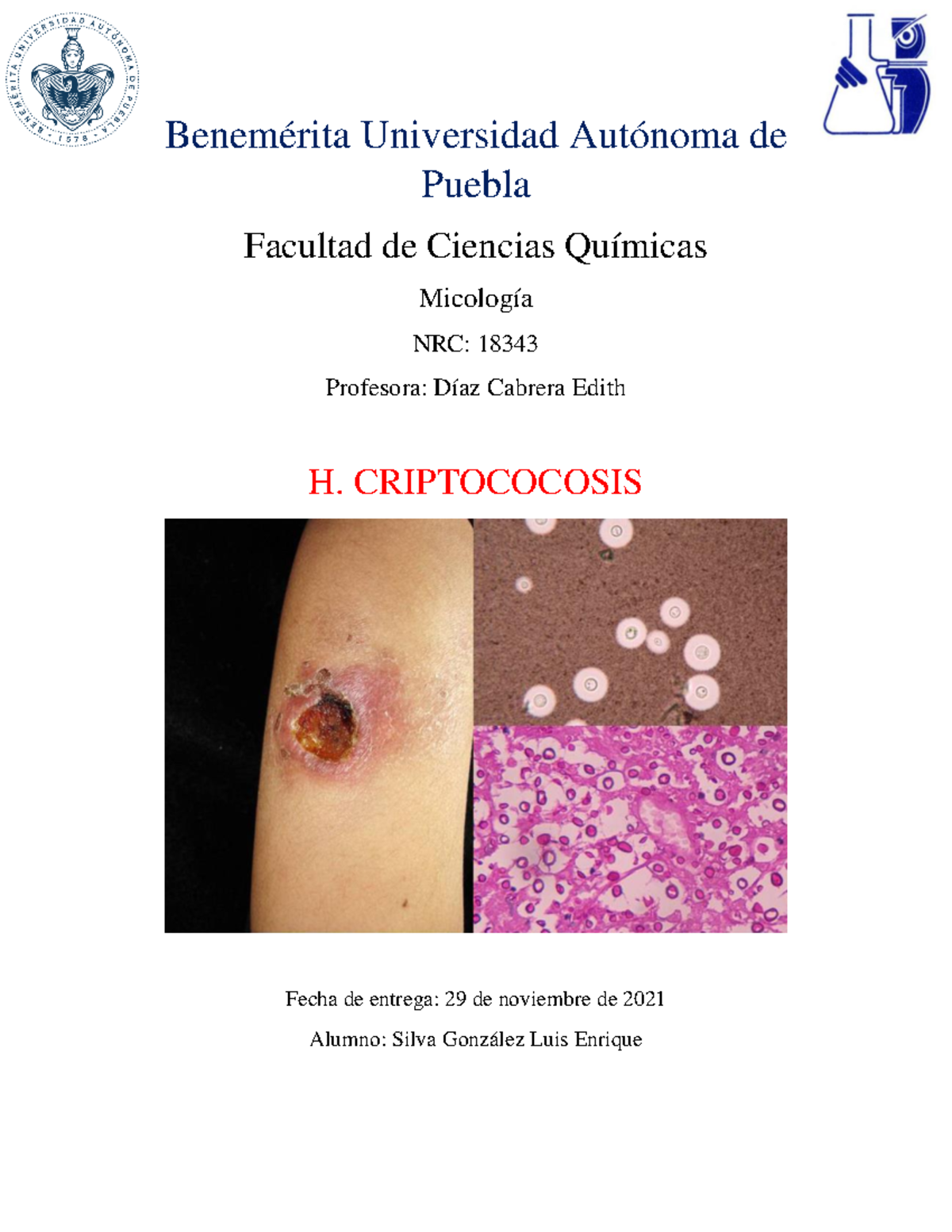 H. Criptococosis - Benemérita Universidad Autónoma de Puebla Facultad ...