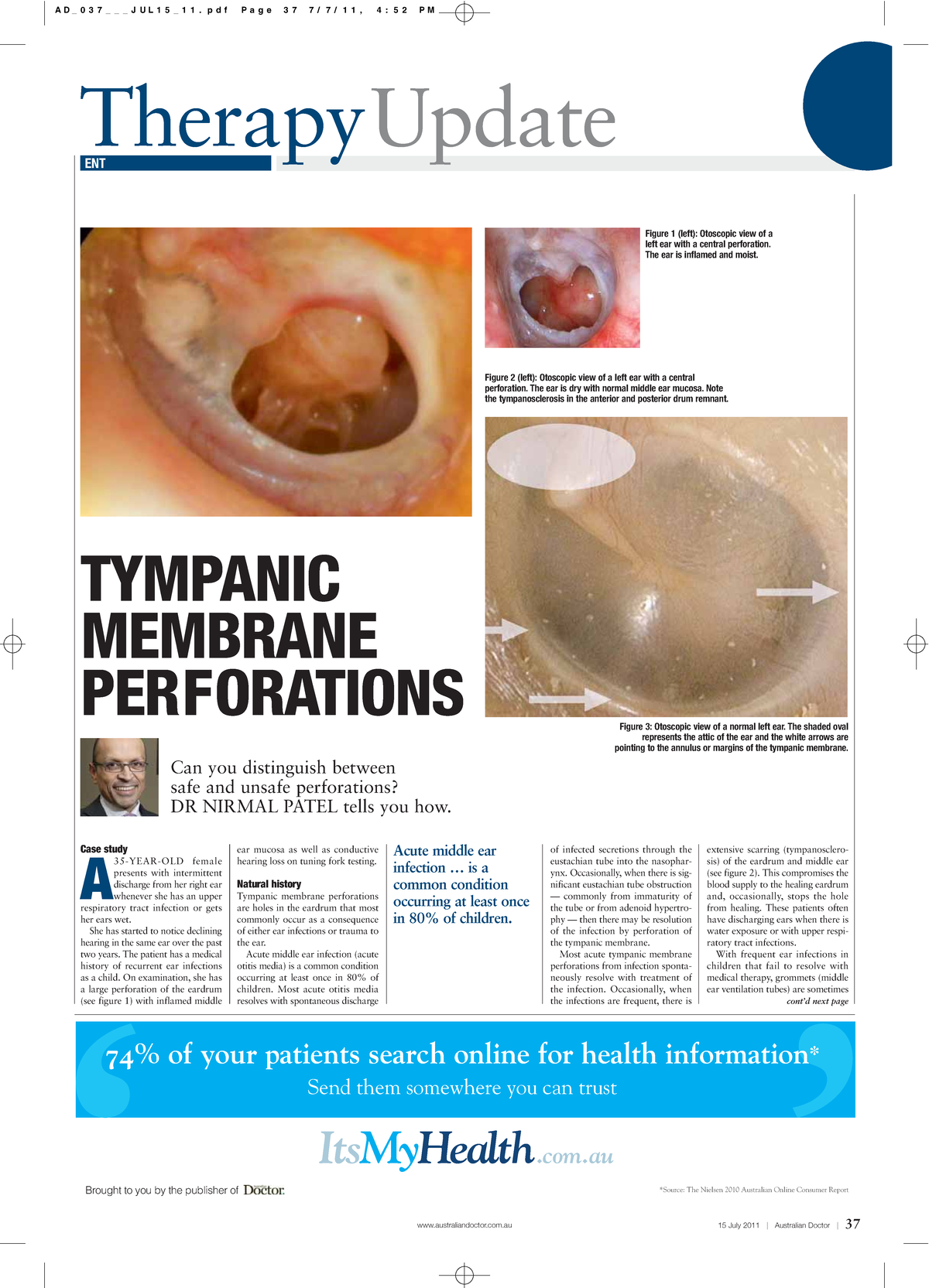 Tympanic-Membrane-Perforations-Update Dr-Nirmal-Patel article 1 - ENT ...