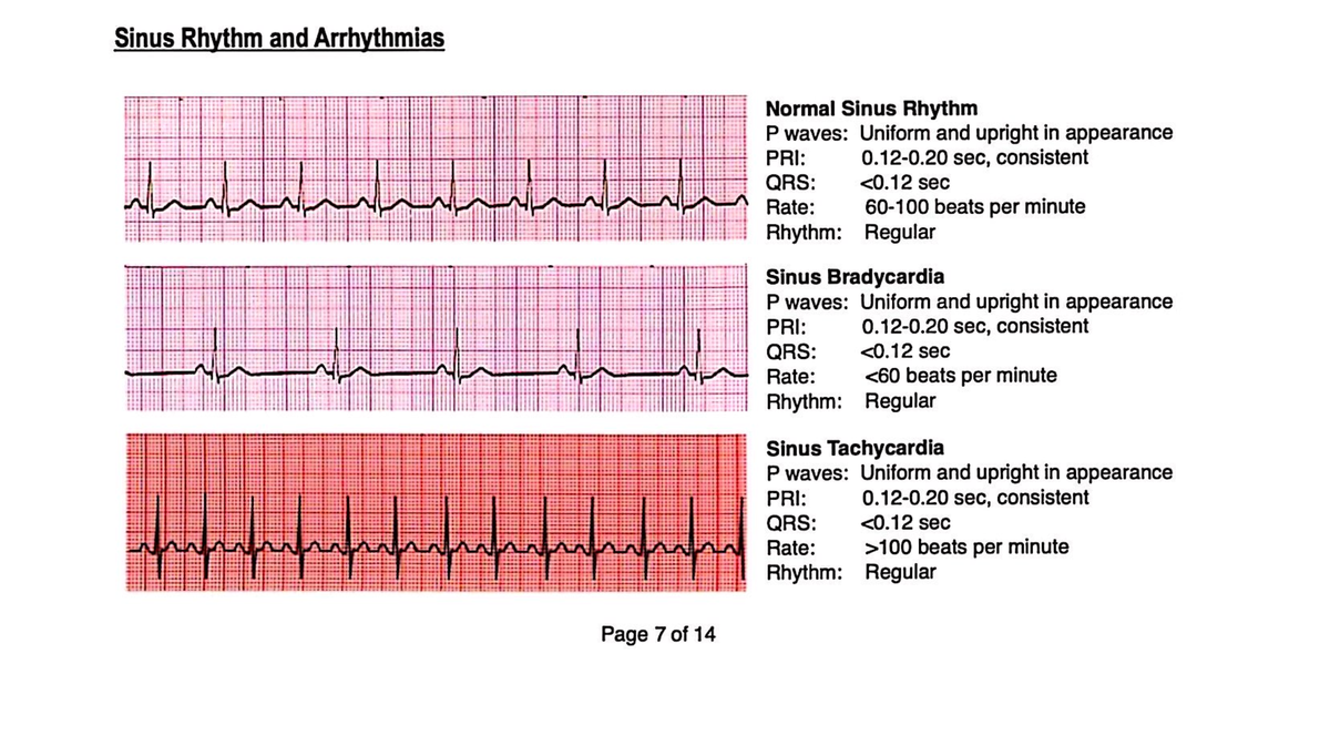 ECG Reading with Pictures - Sinus Rhythm and Arrhythmias Normal Sinus ...
