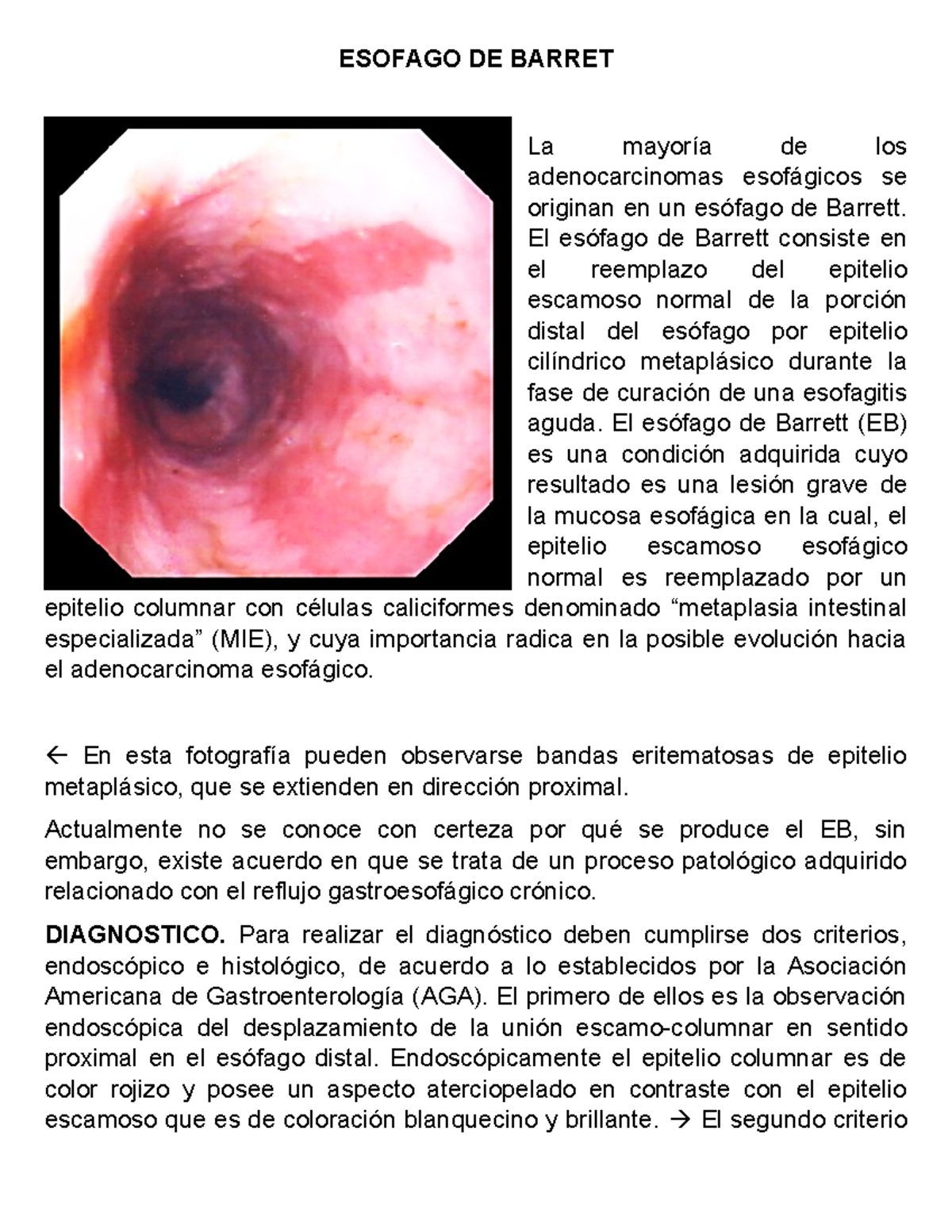 02. Esofago DE Barret - ESOFAGO DE BARRET La mayoría de los ...