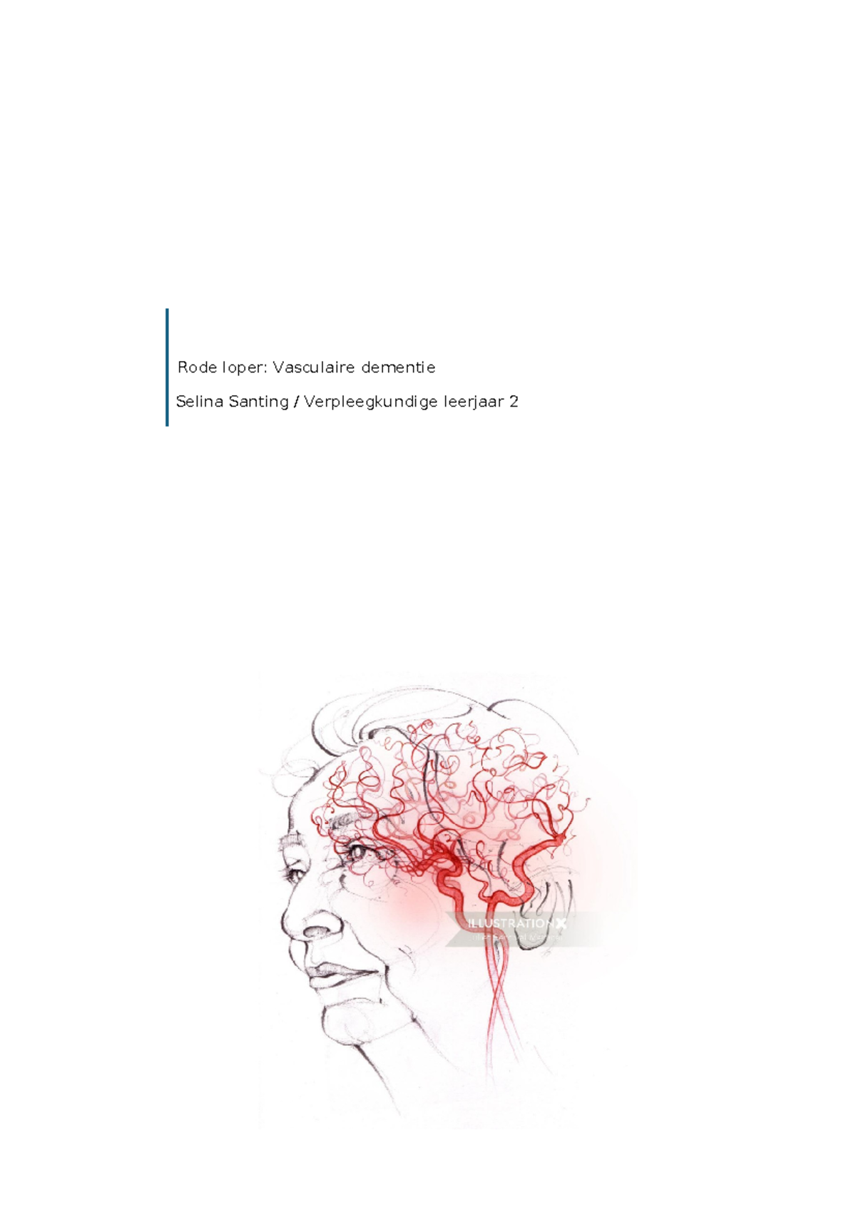 Rode loper Vasculaire dementie - Rode loper: Vasculaire dementie Selina ...