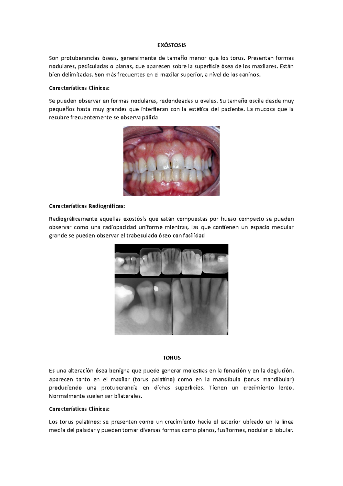 Exóstosis - EXÓSTOSIS Son protuberancias óseas, generalmente de tamaño ...