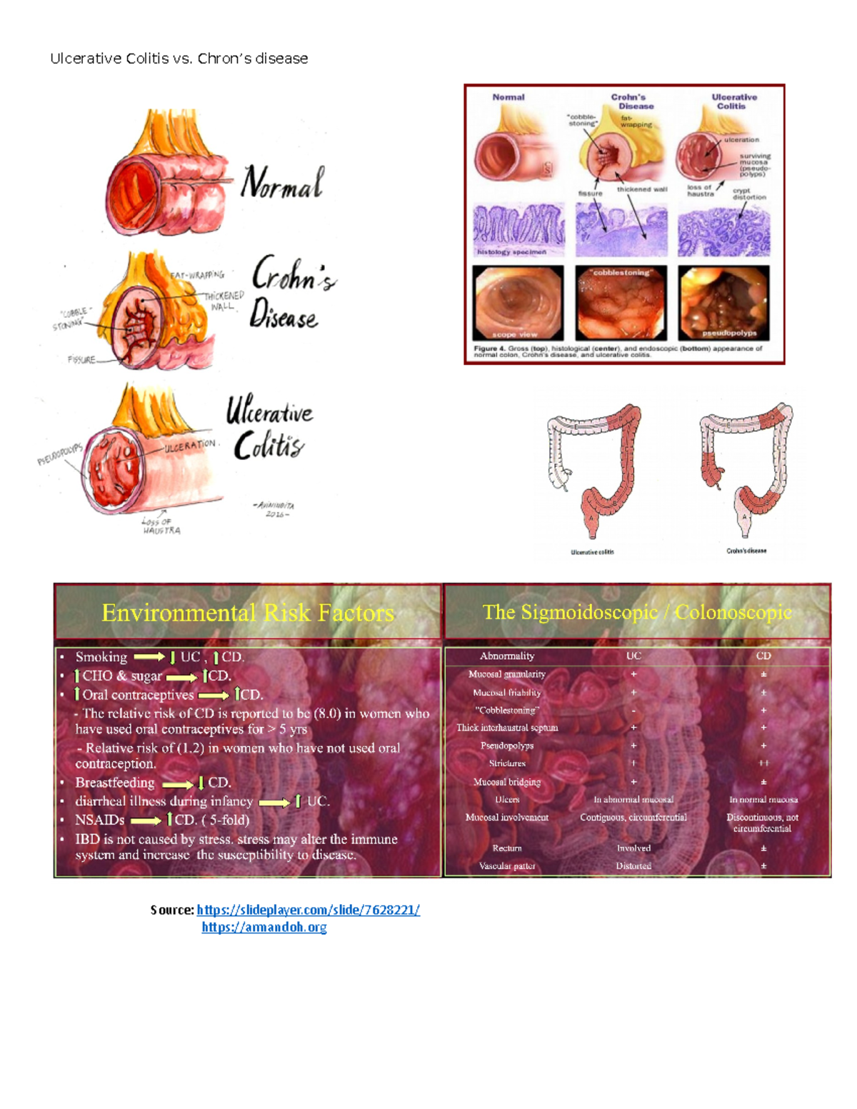 IBD - Chron's Disease, Ulcerative Cholitis - PHAS 600 - Ulcerative ...