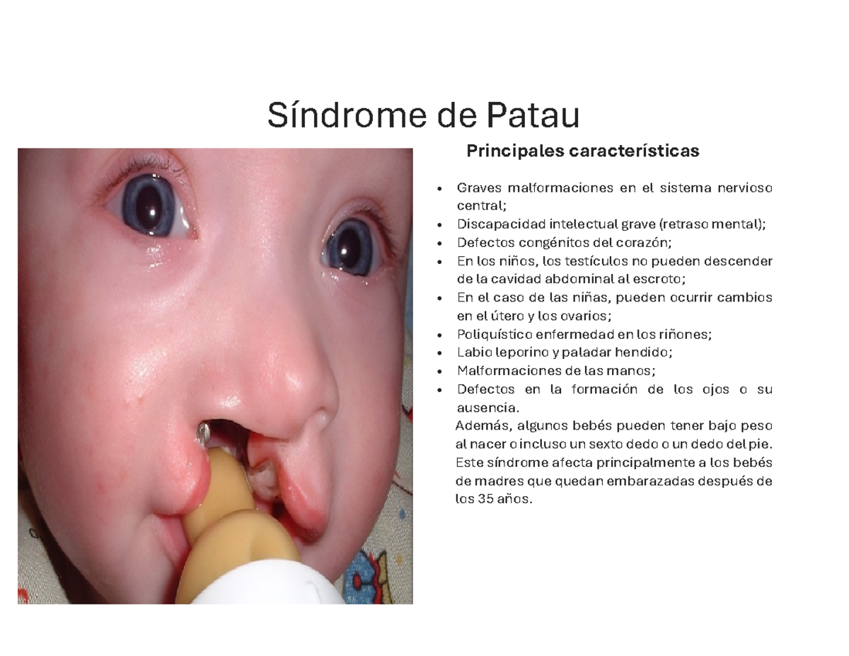 Sindromes 10 - .... - Síndrome de Patau Principales características ...
