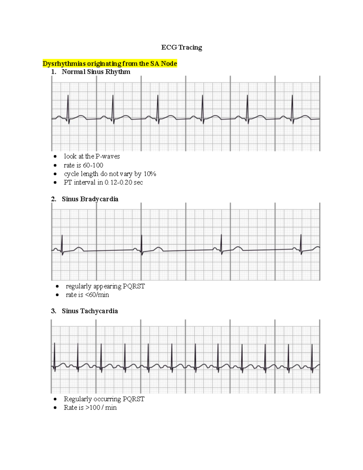ECG- Tracing- Reviewer - ECG Tracing Dysrhythmias originating from the ...
