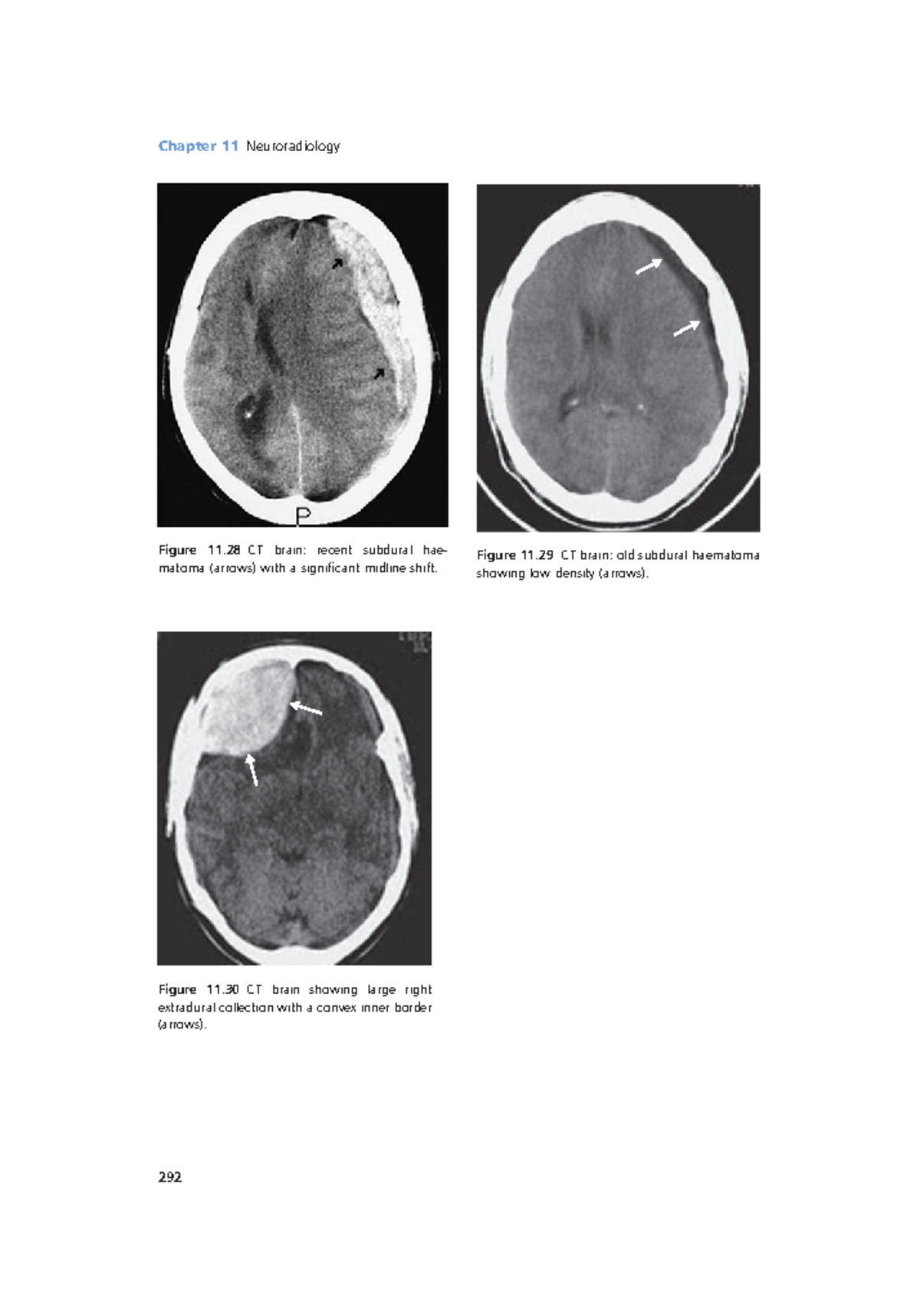 Radiology Lecture Notes Pdf 98 Chapter 11 Neuroradiology 292 Figure 11 Ct Brain Recent