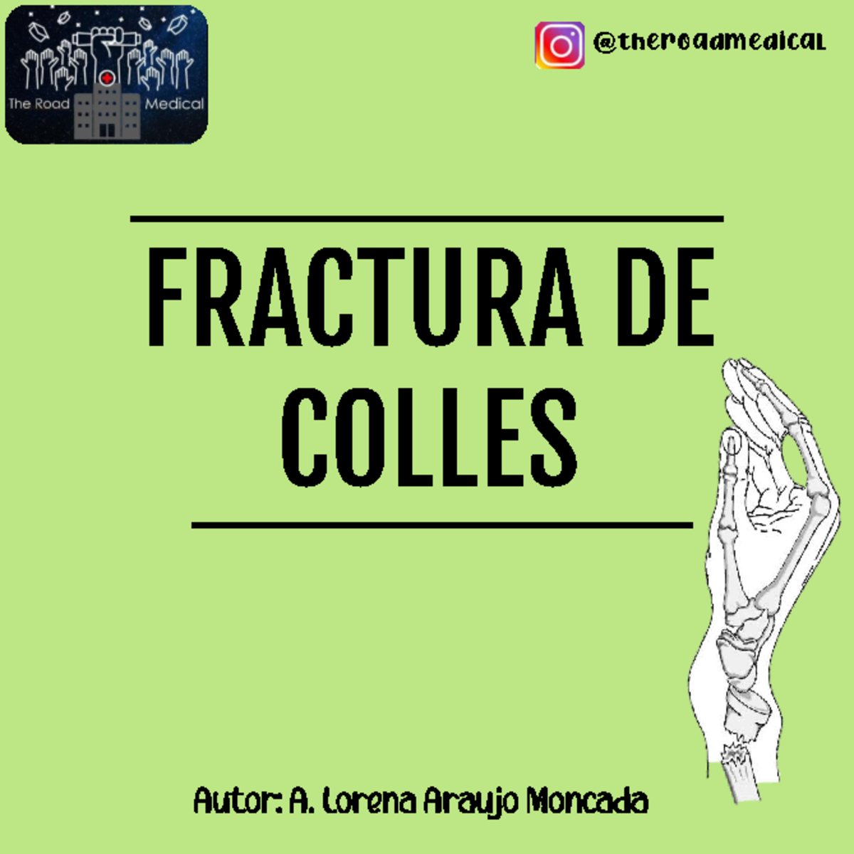 Fx colles - FRACTURA DE COLLES Definición: Fxde rasgo transversal de la ...