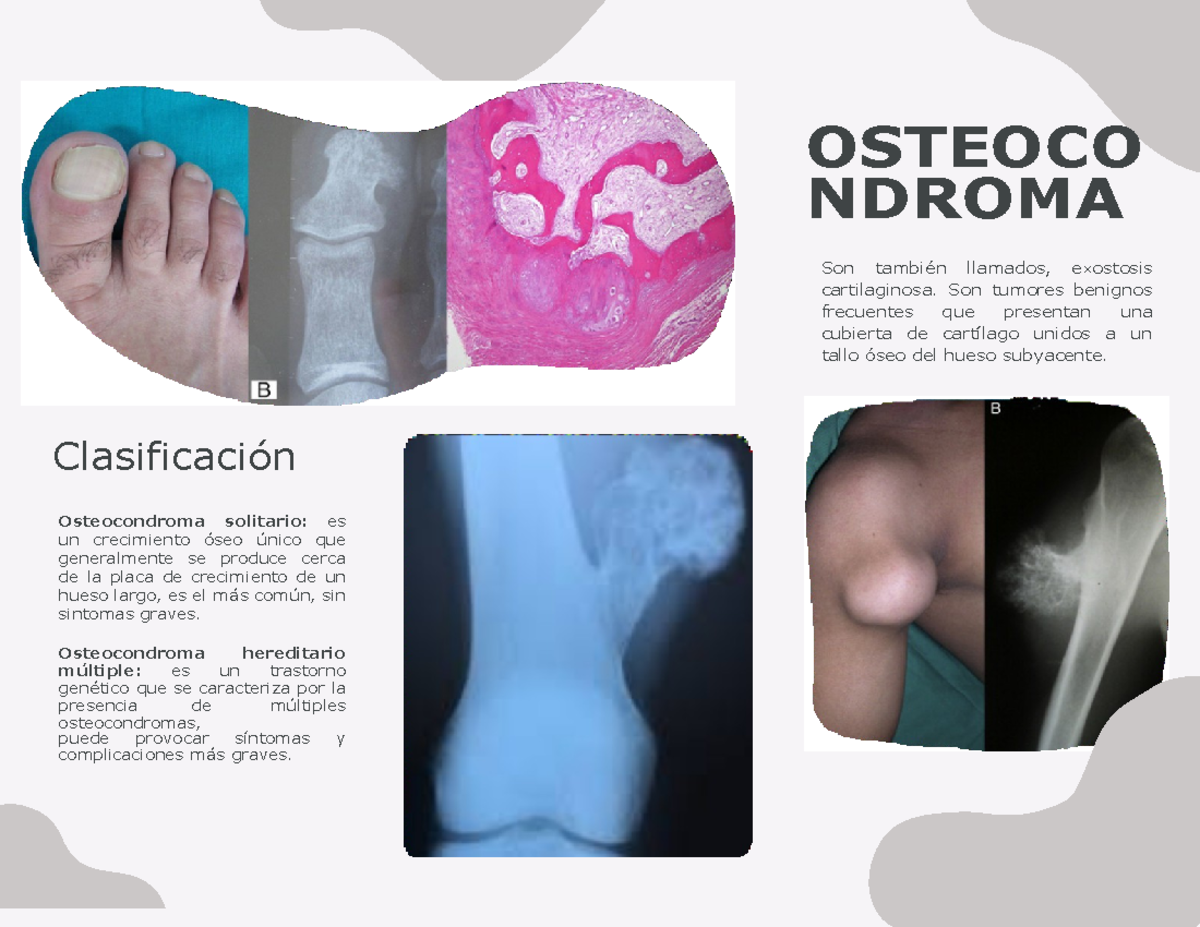 Osteocondroma - Brochure - OSTEOCO NDROMA Son también llamados ...
