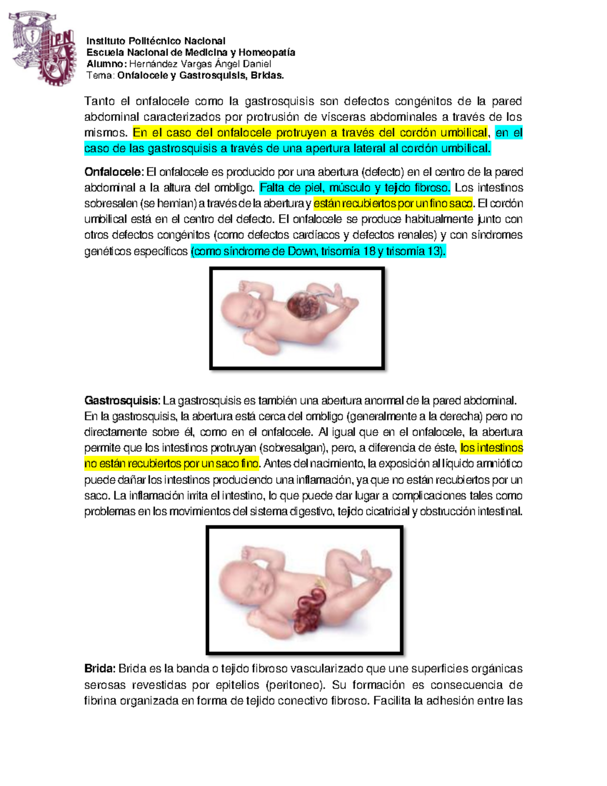 Onfalocele y Gastrosquisis, Bridas - Tanto el onfalocele como la ...