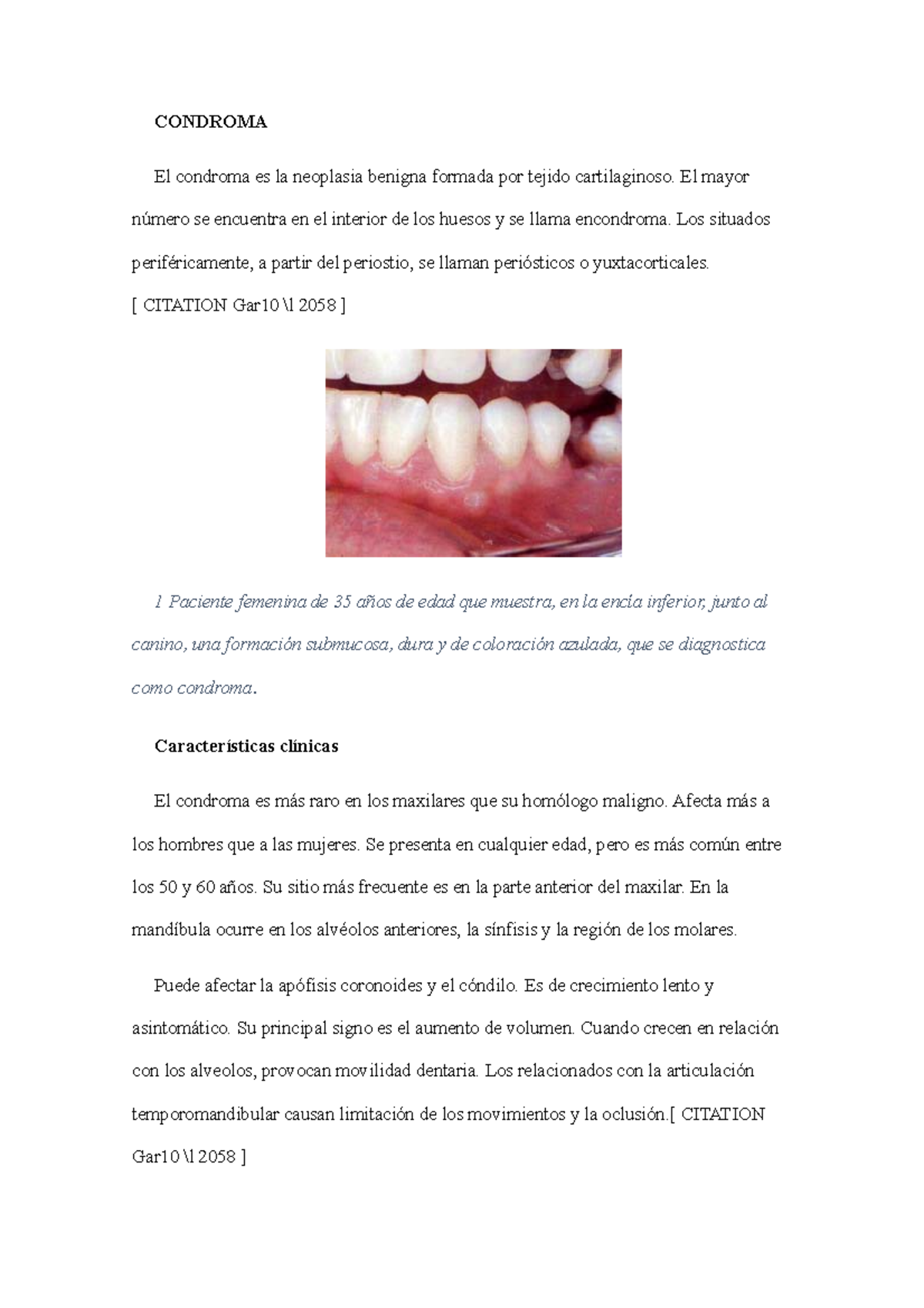 Condroma - CONDROMA El condroma es la neoplasia benigna formada por ...