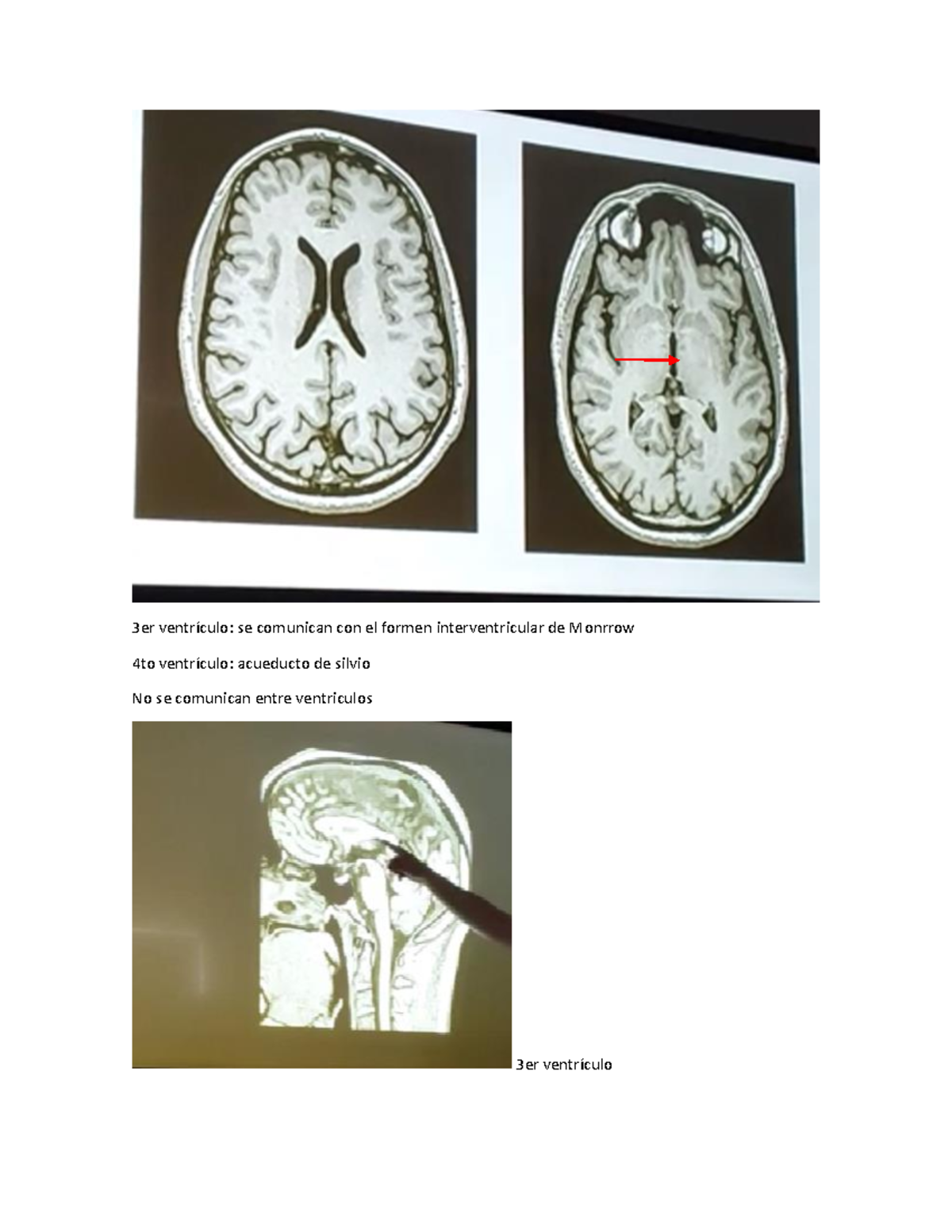 3er ventrículo - apuntes - 3er ventrículo: se comunican con el formen ...