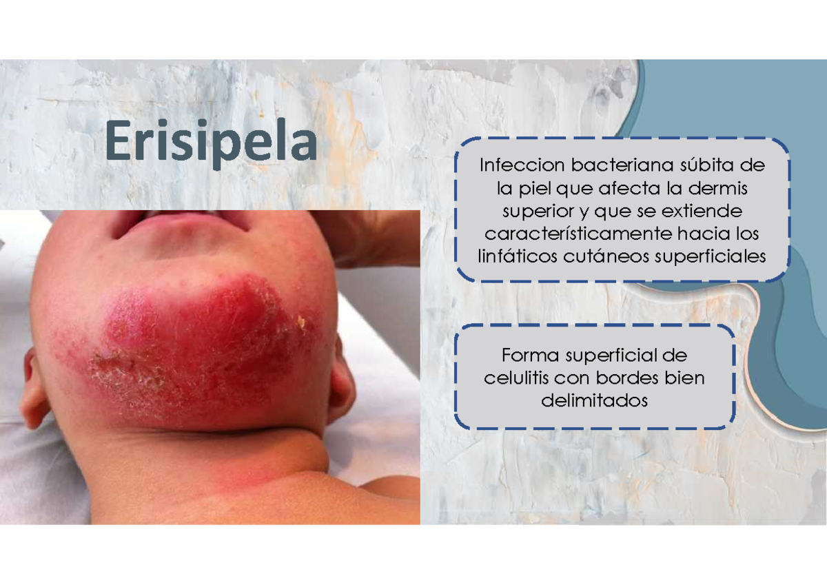 Erisipela Erisipela Infeccion Bacteriana Súbita De La