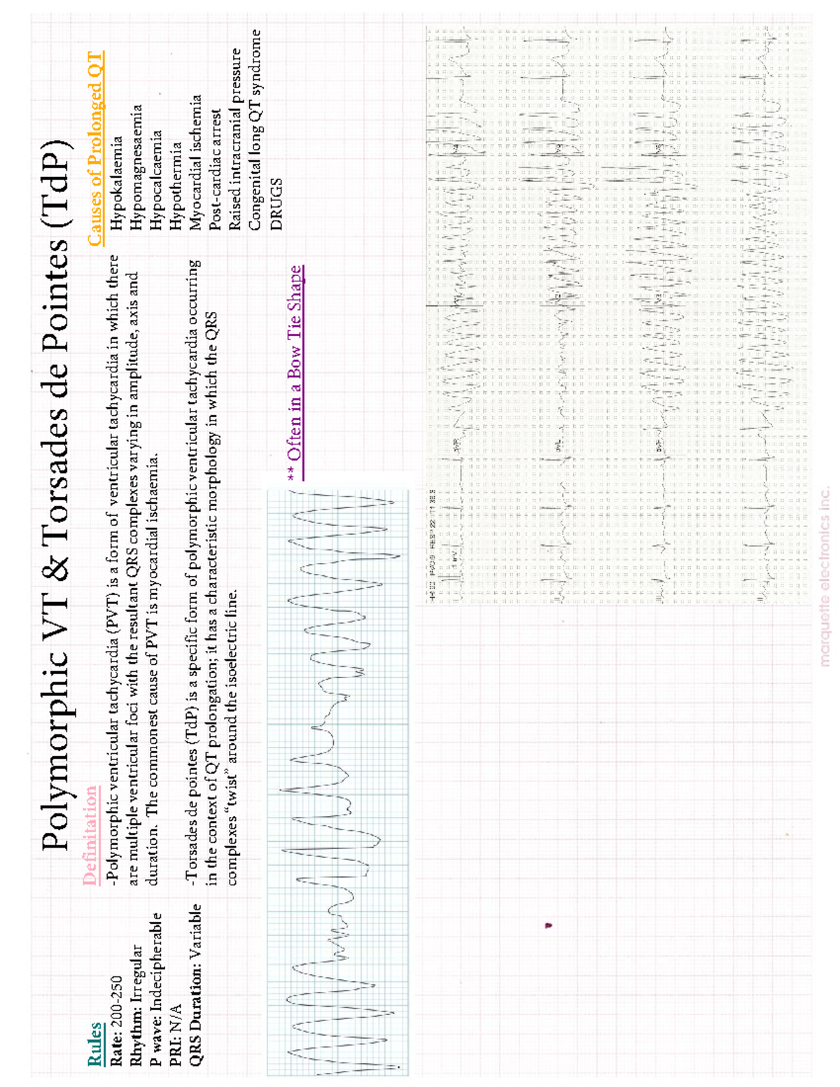 Td P - EKG information - Polymorphic VT & Torsades de Pointes (TdP ...