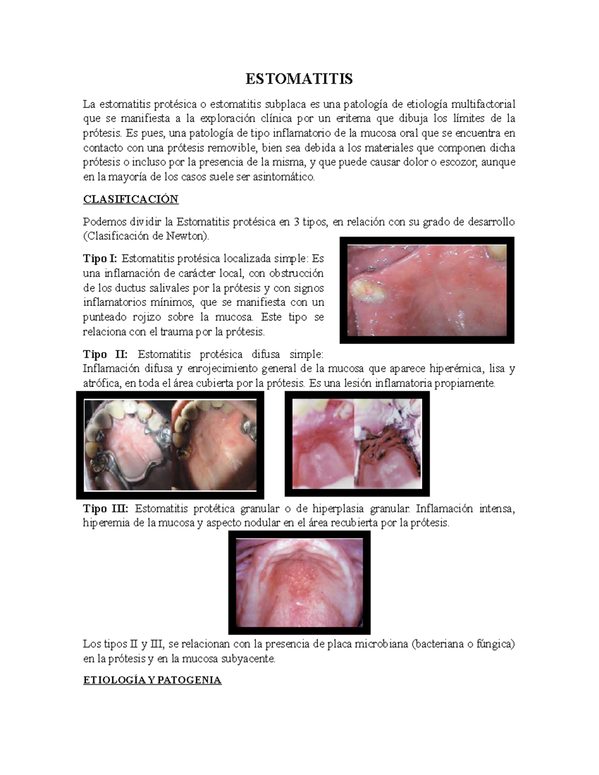 Estomatitis-Hiperplasia - ESTOMATITIS La estomatitis protésica o ...
