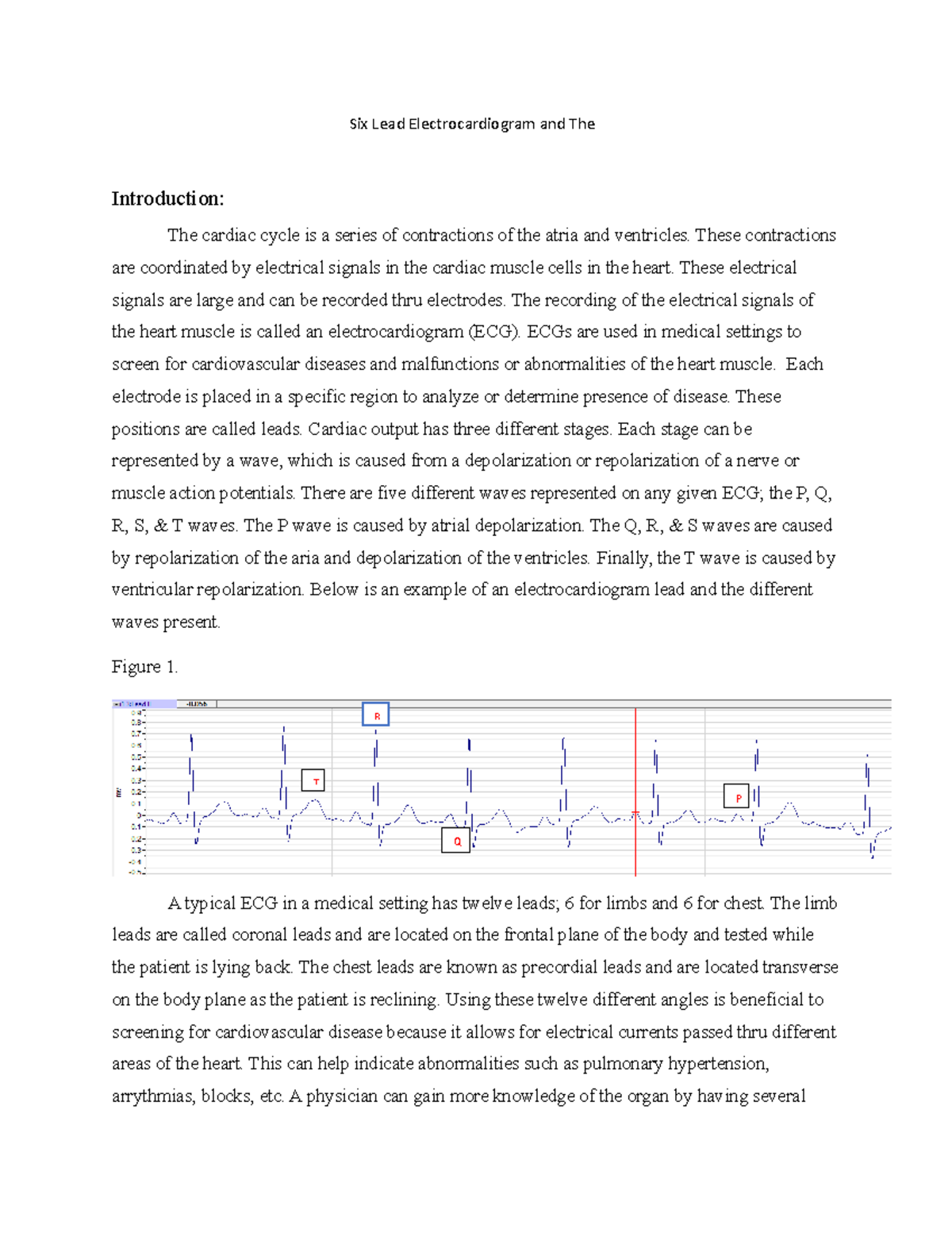 6 lead ecg - study - Six Lead Electrocardiogram and The Introduction ...