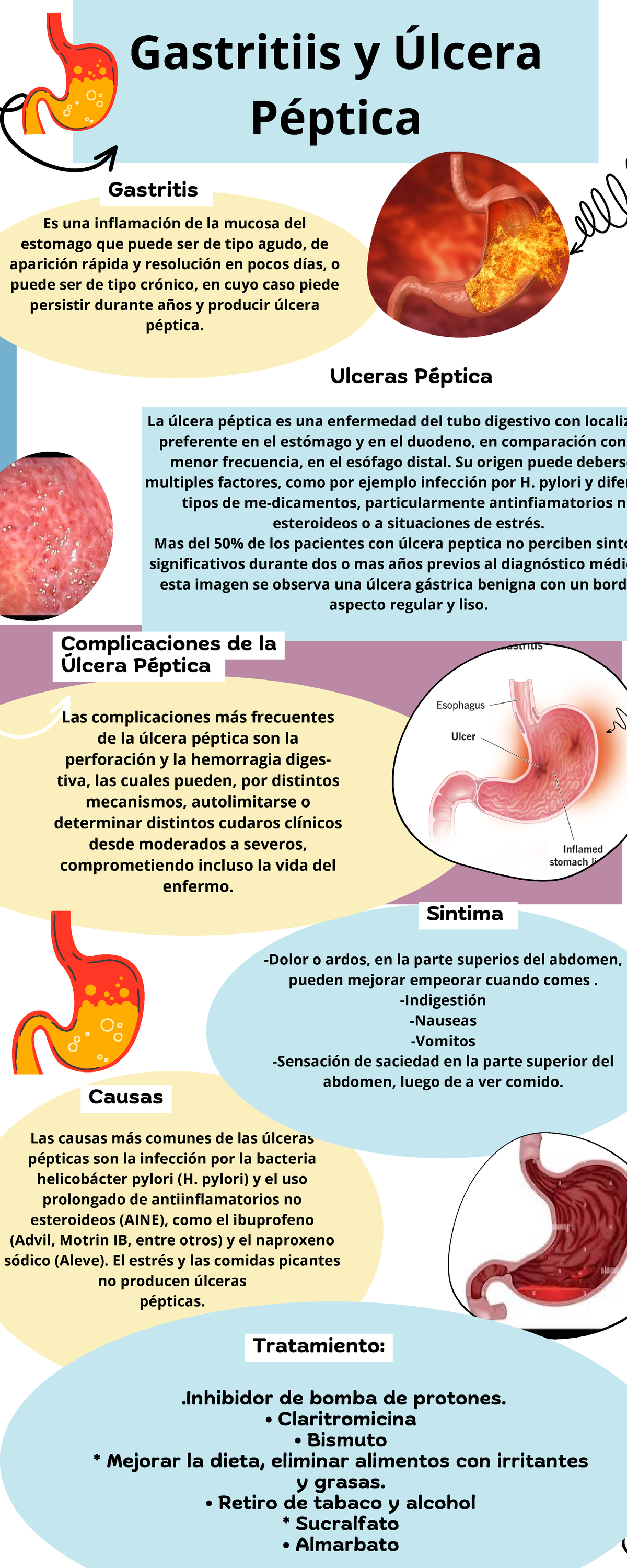 Infografia gastro - La úlcera péptica es una enfermedad del tubo ...