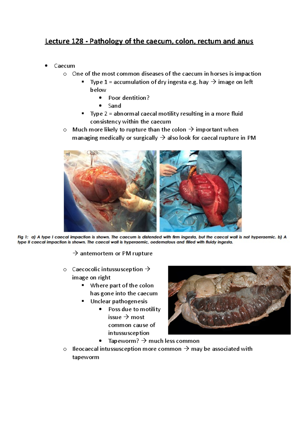 Lecture 128 - Pathology of the caecum, colon, rectum and anus. - hay image on left below Poor ...