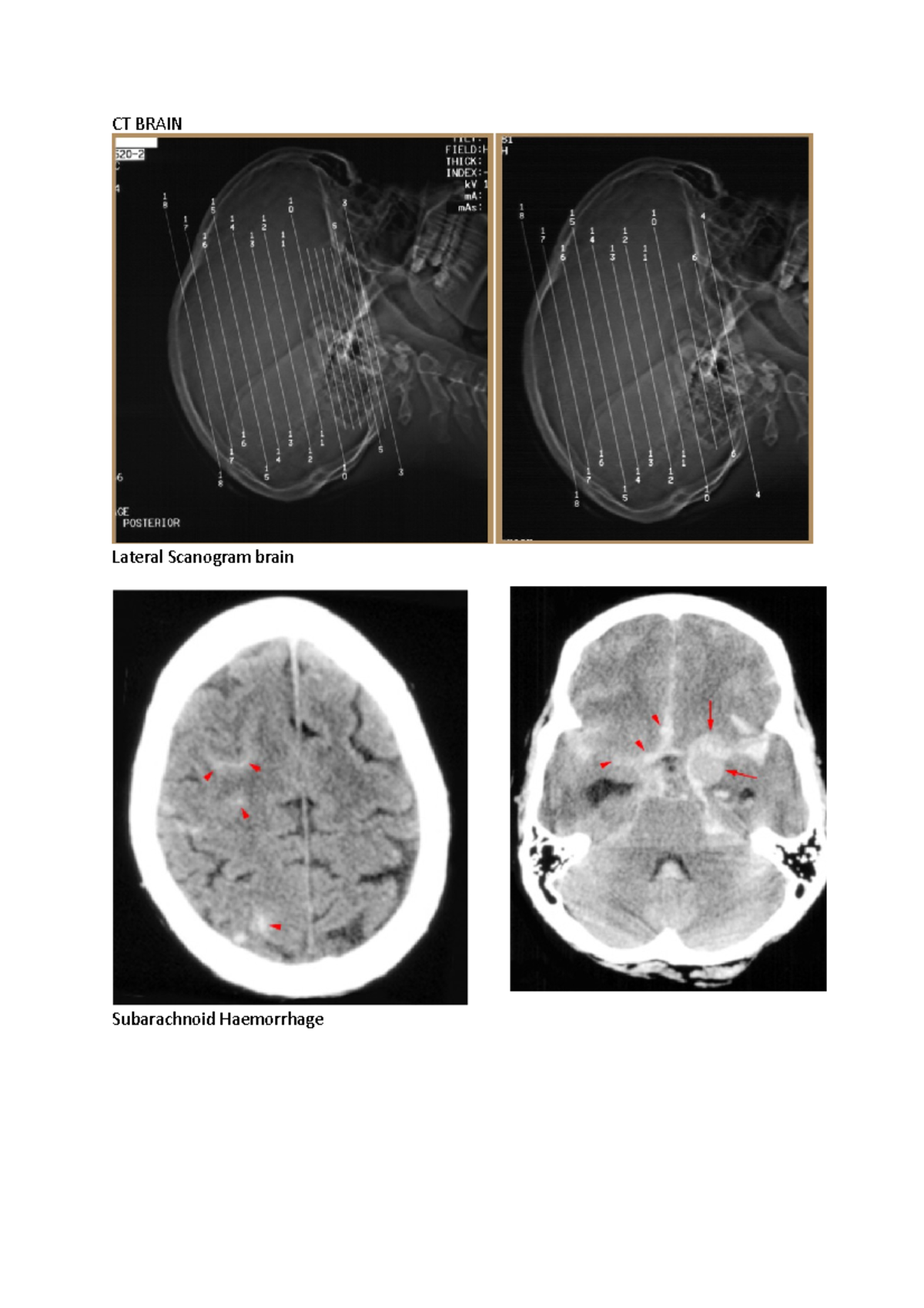 CT Brain - pictures of ct - MRSC2110 - CT BRAIN Lateral Scanogram brain ...