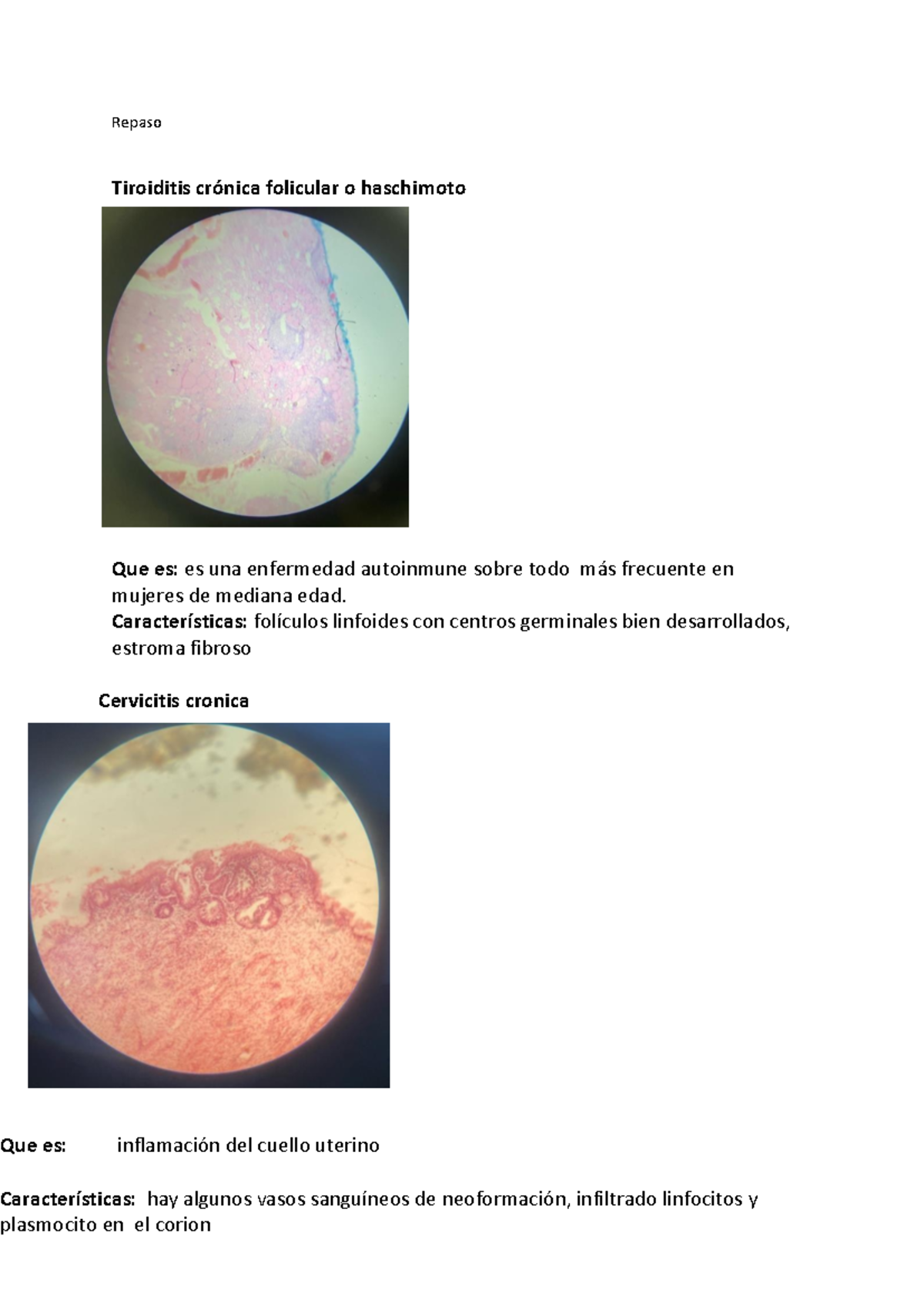 Documento - Repaso Tiroiditis crónica folicular o haschimoto Que es: es ...
