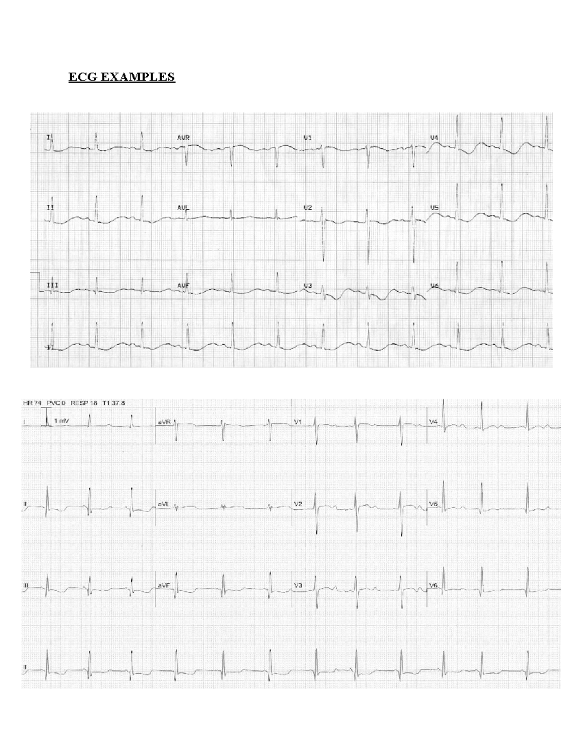 ECG examples - MBChB - ECG EXAMPLES - Studocu