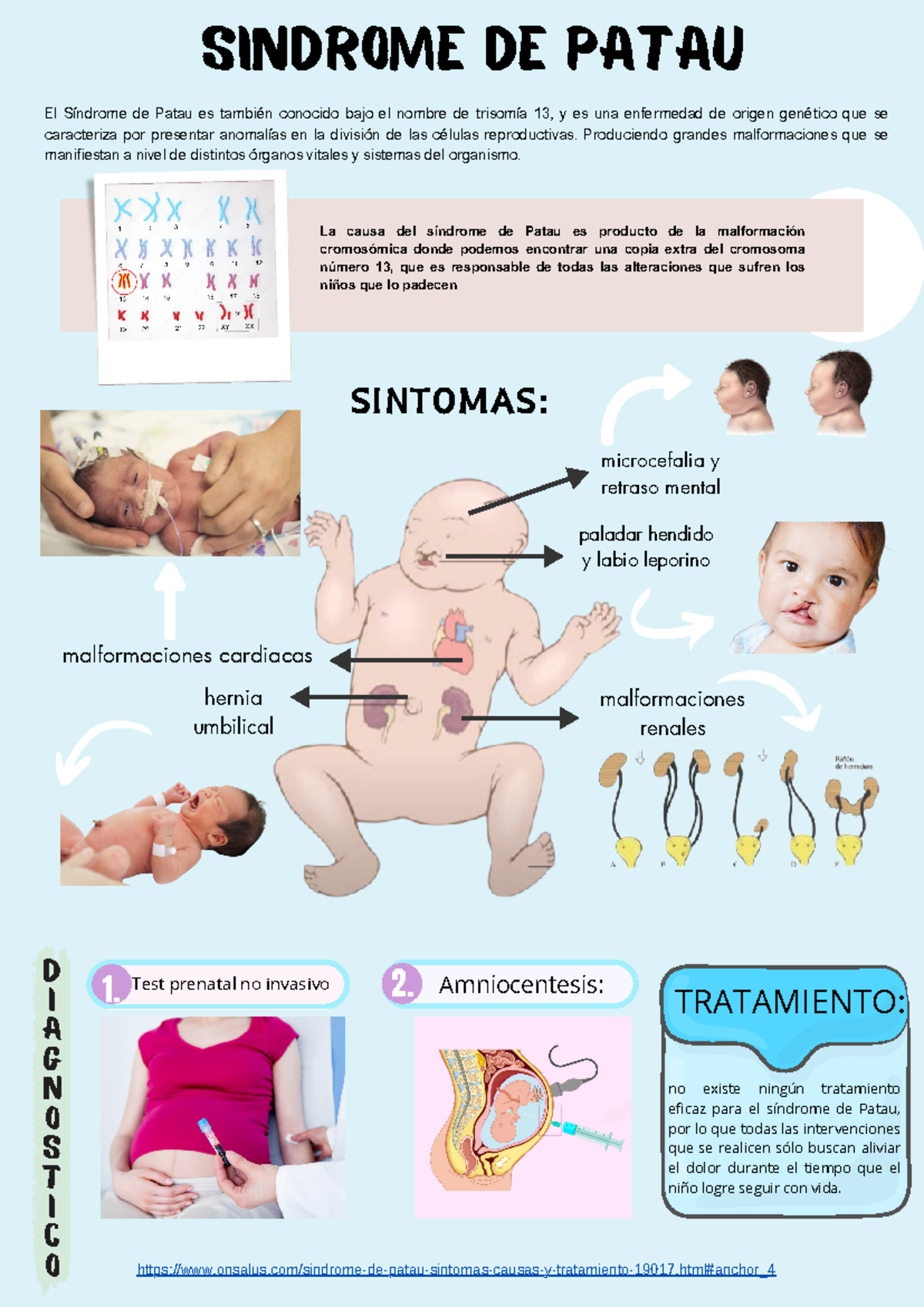 Sindrome de patau - ENFERMERIA - El Síndrome de Patau es también ...