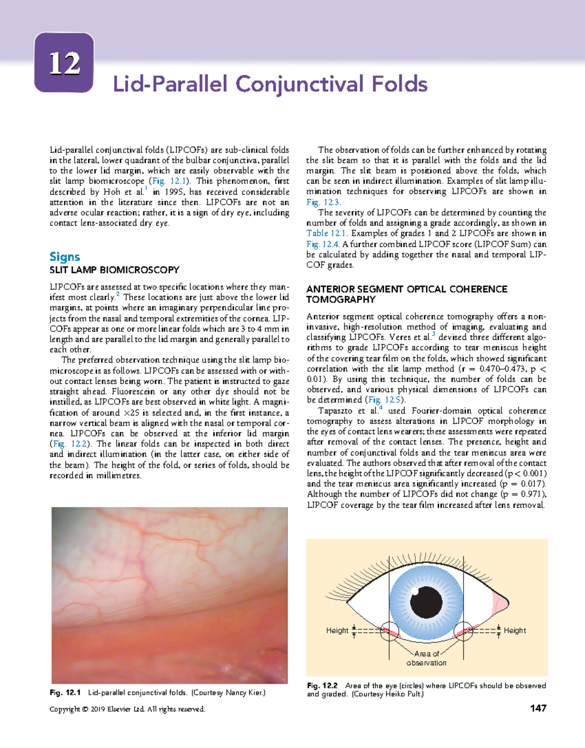 Lid Parallel Conjunctival Folds Contact Lens Complications - 1212 Lid ...