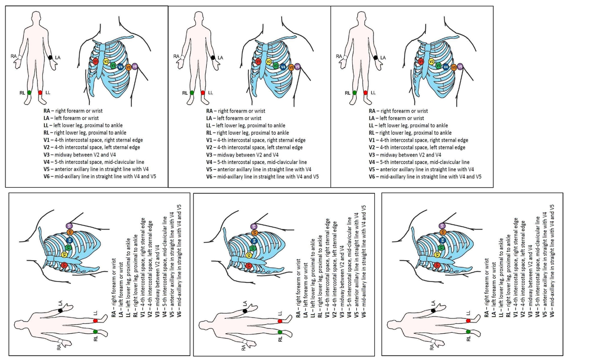ECG LEAD Placement - CHN - Nursing - Studocu