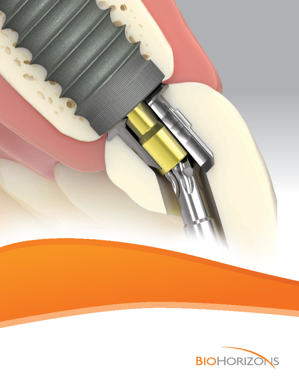 140939 - implantes - Using authentic BioHorizons parts will ensure a ...