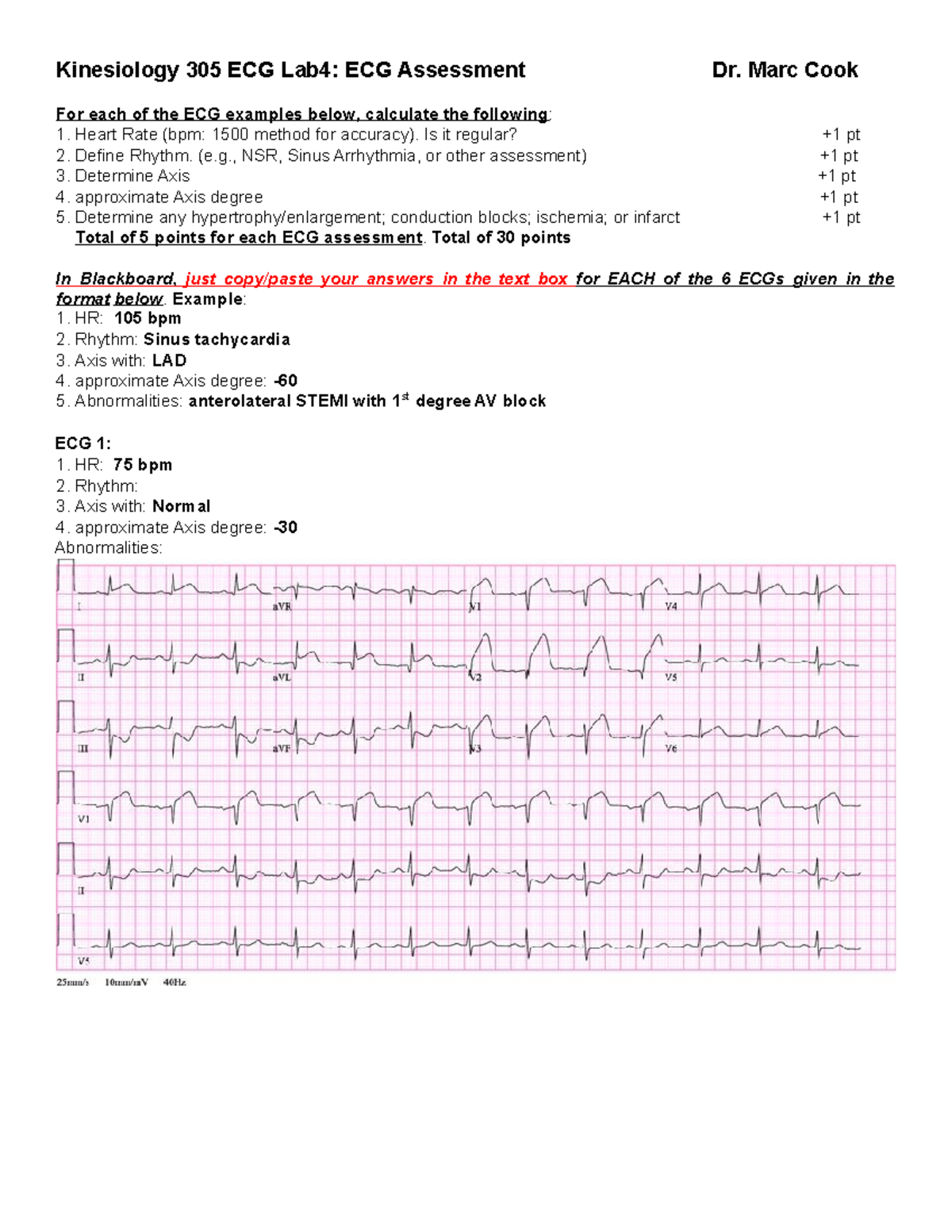 Lab 4 ECG Assessment Week 13-14 - For each of the ECG examples below ...
