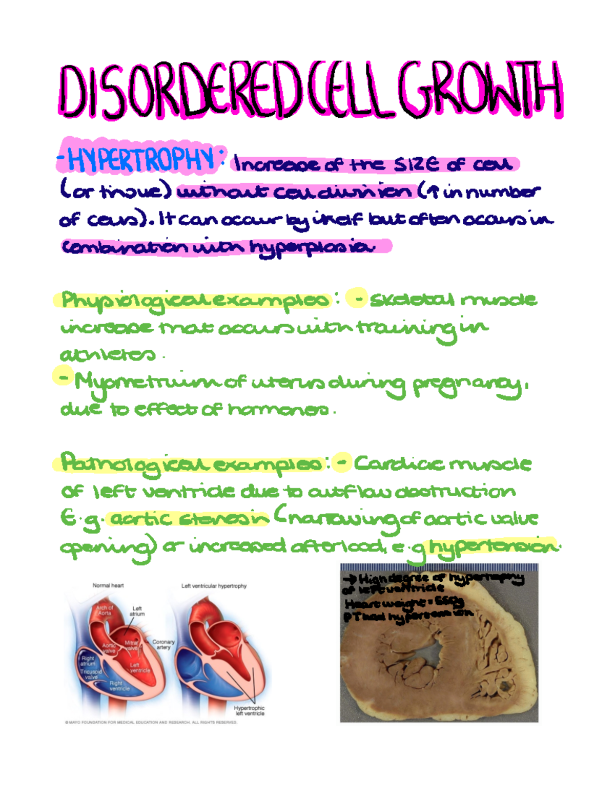 Disordered cell grown and neoplasia - DISORDERED CELLGROWTH HYPERTROPHY ...
