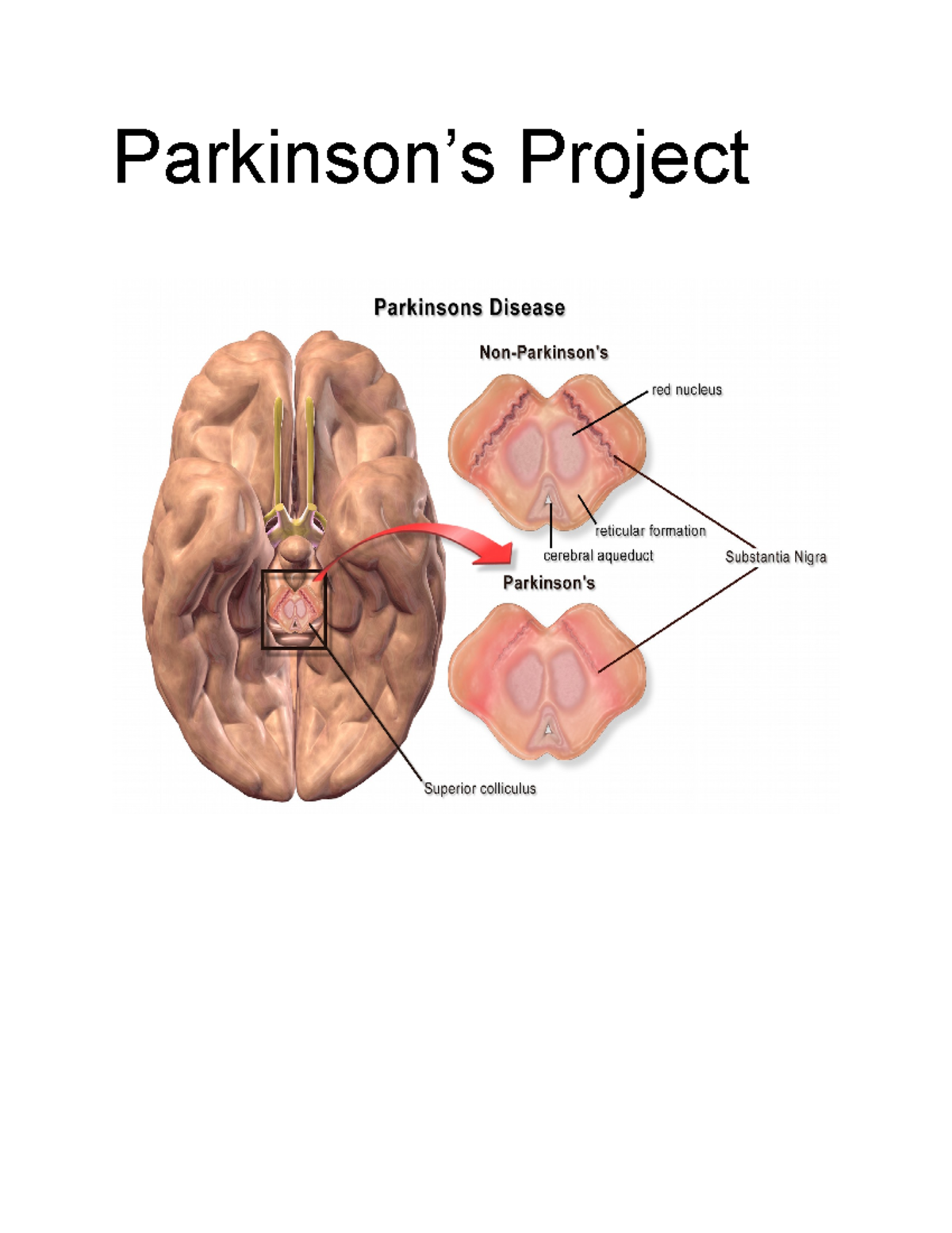 Parkinson’s Project - Notes about parkinsons - Parkinson’s Project ...