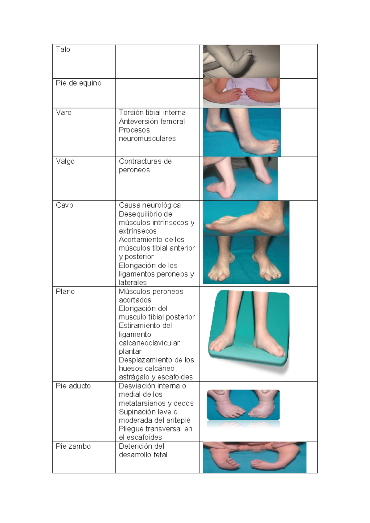 Alteraciones - Talo Pie de equino Varo Torsión tibial interna ...