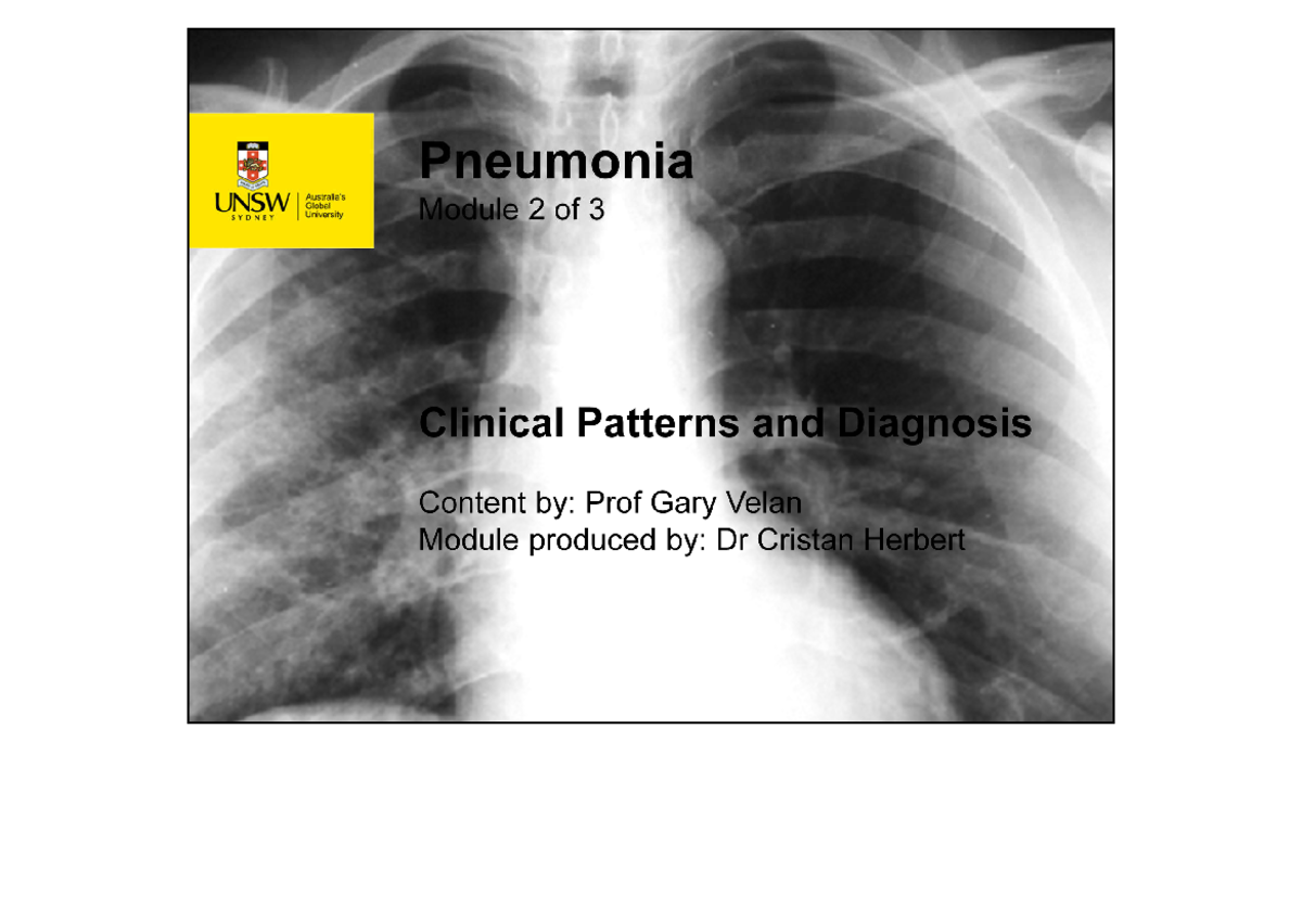 08 - Pneumonia module 2 - Chest X-rays showing consolidation in right ...