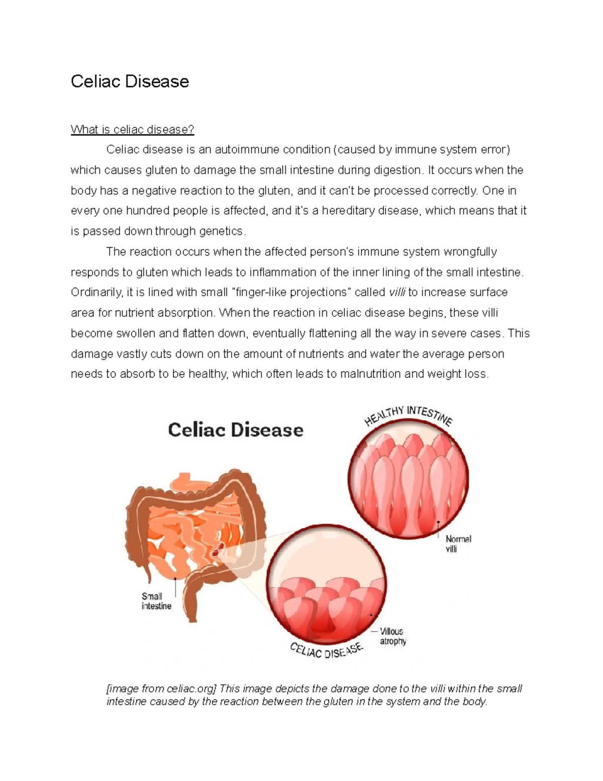 Celiac Disease Handout - Celiac Disease What is celiac disease? Celiac ...