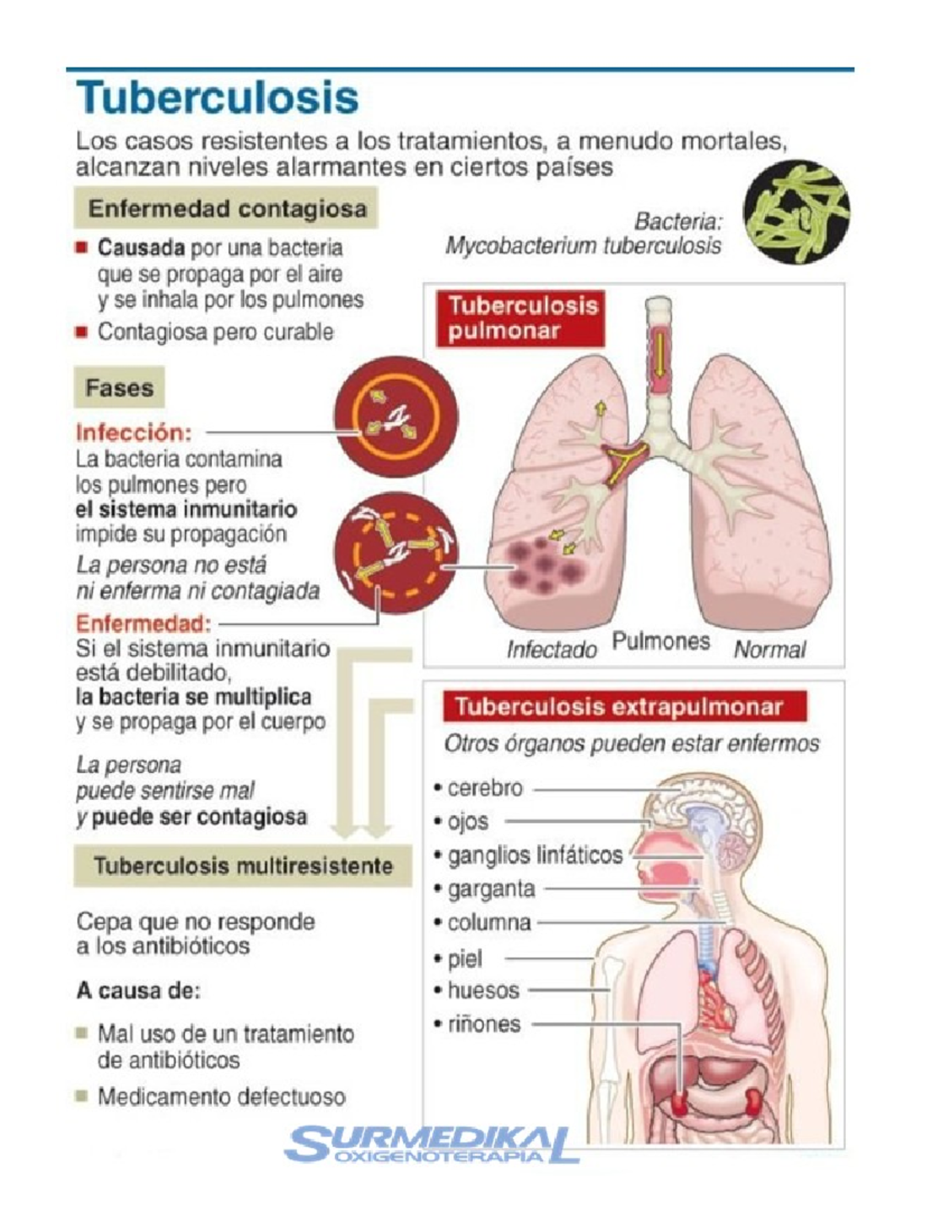Tuberculosis sobre los pulmones para - Biología - Studocu