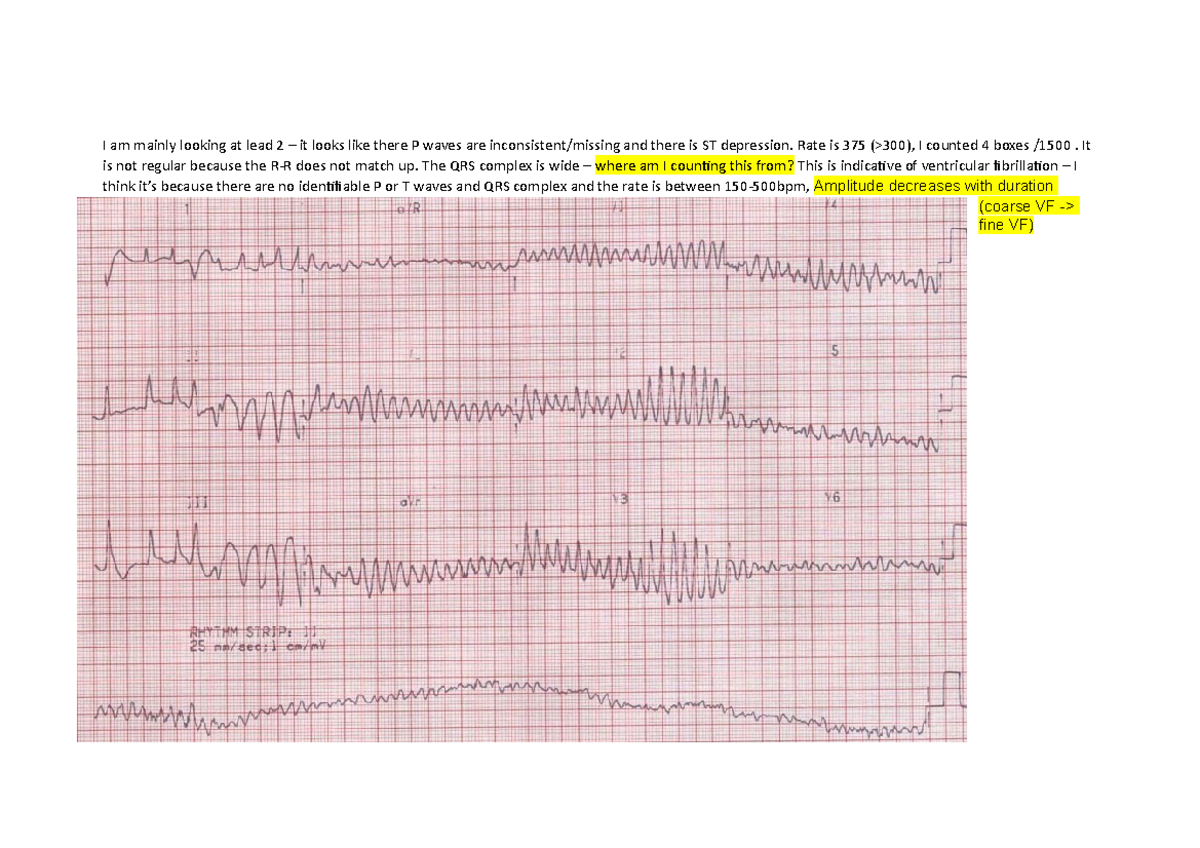 ECG - ecg practice - I am mainly looking at lead 2 – it looks like ...