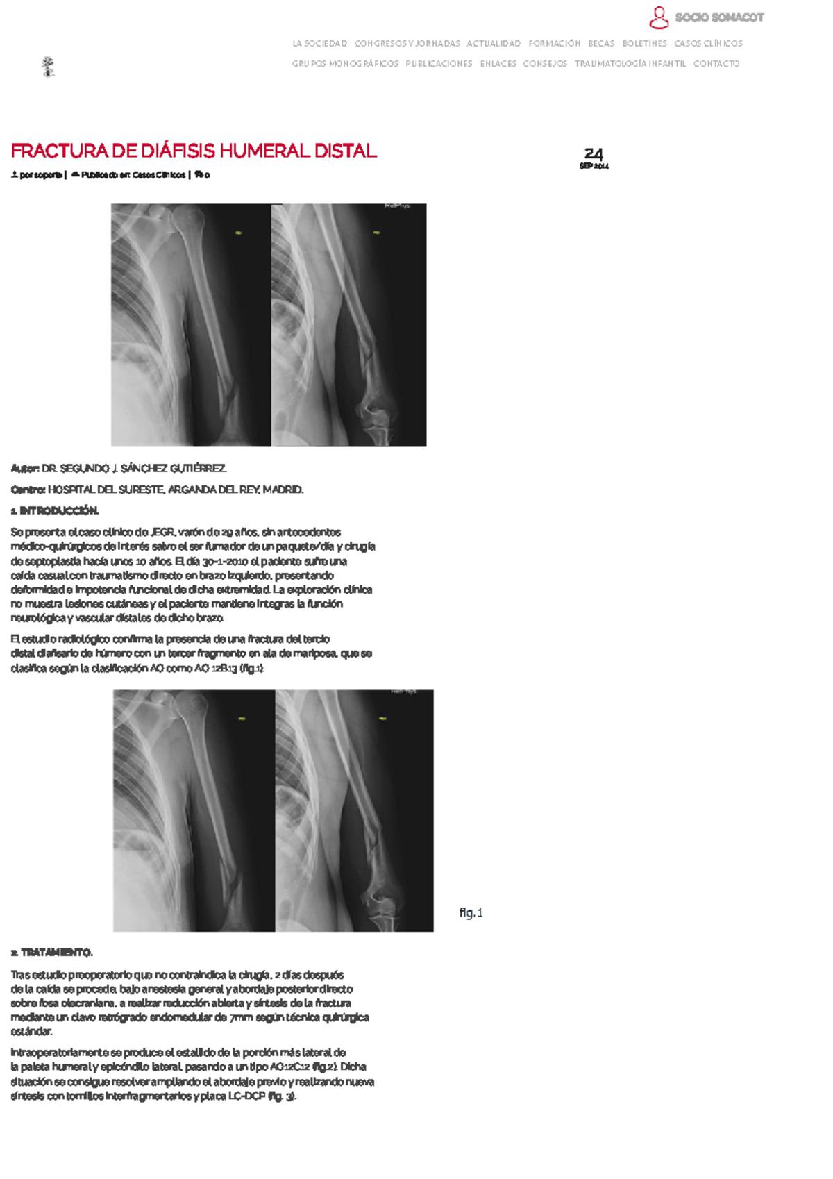 Fractura DE Diáfisis Humeral Distal - Somacot - Sociedad Matritense de ...