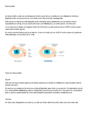 Dacriocistitis - La dacrioadenitis es la inflamación de la glándula que ...