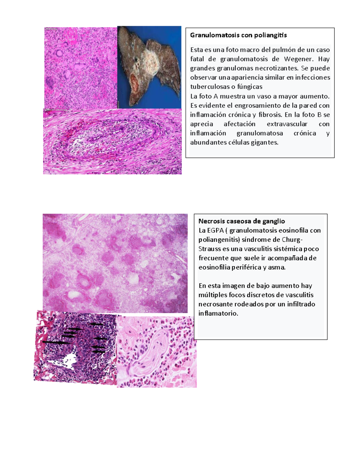 Imagenes Vasculitis - nose - Granulomatosis con poliangitis Esta es una ...