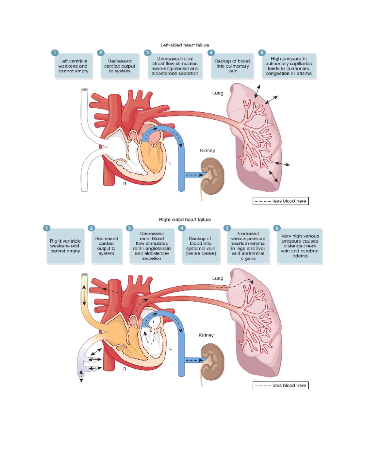 LEFT VS RT Sided HF - patho exam - Heart Failure: Left sided VS Right sided Heart failure is a ...