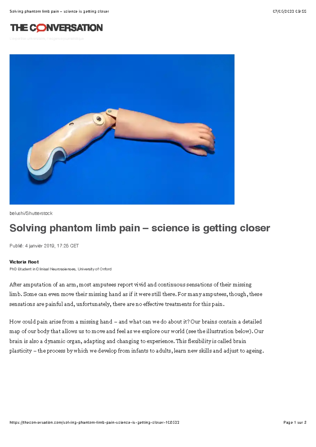 Solving phantom limb pain – science is getting closer - Some can even ...