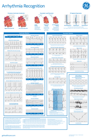 Arrhythmia Recognition Part 1 and 2 DOC1178264 Rev2 - This is part one ...
