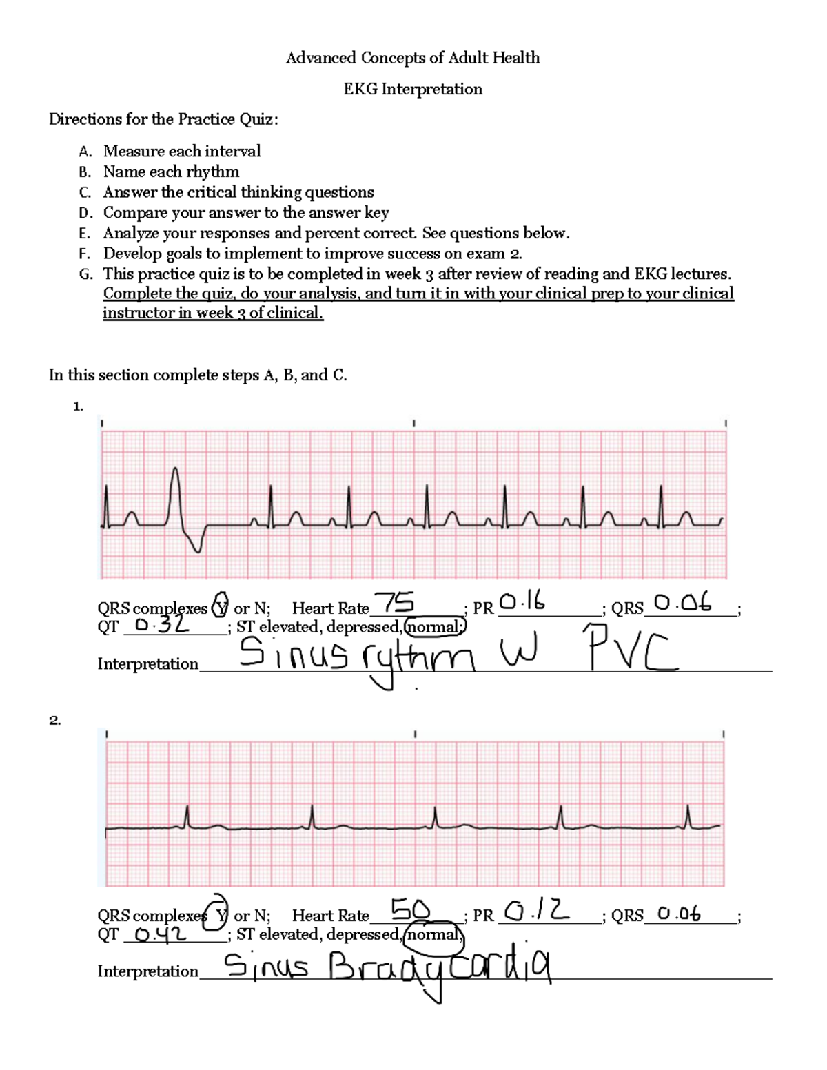 EKG practice quiz 2022 BWS - Advanced Concepts of Adult Health EKG ...