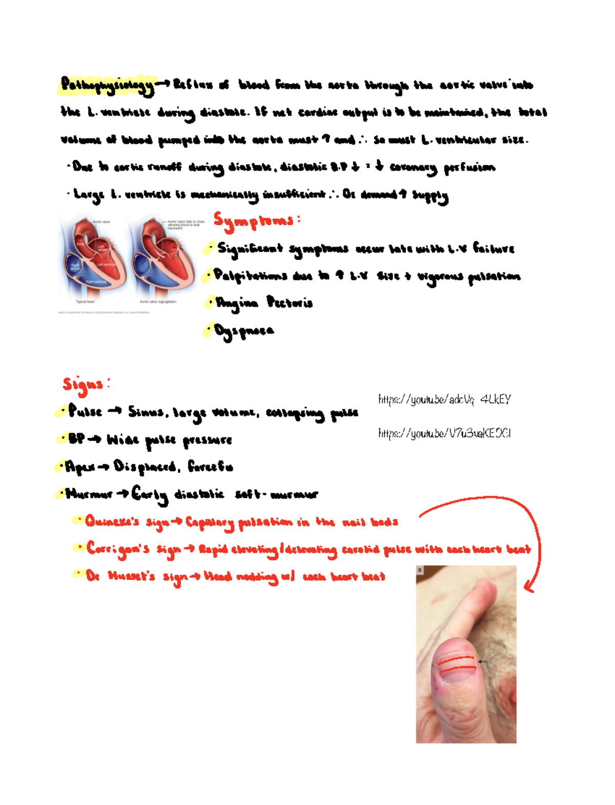 Aortic regurgitation - youtu/adcVq_4LkEY youtu/V7u3vaKEDCI ...