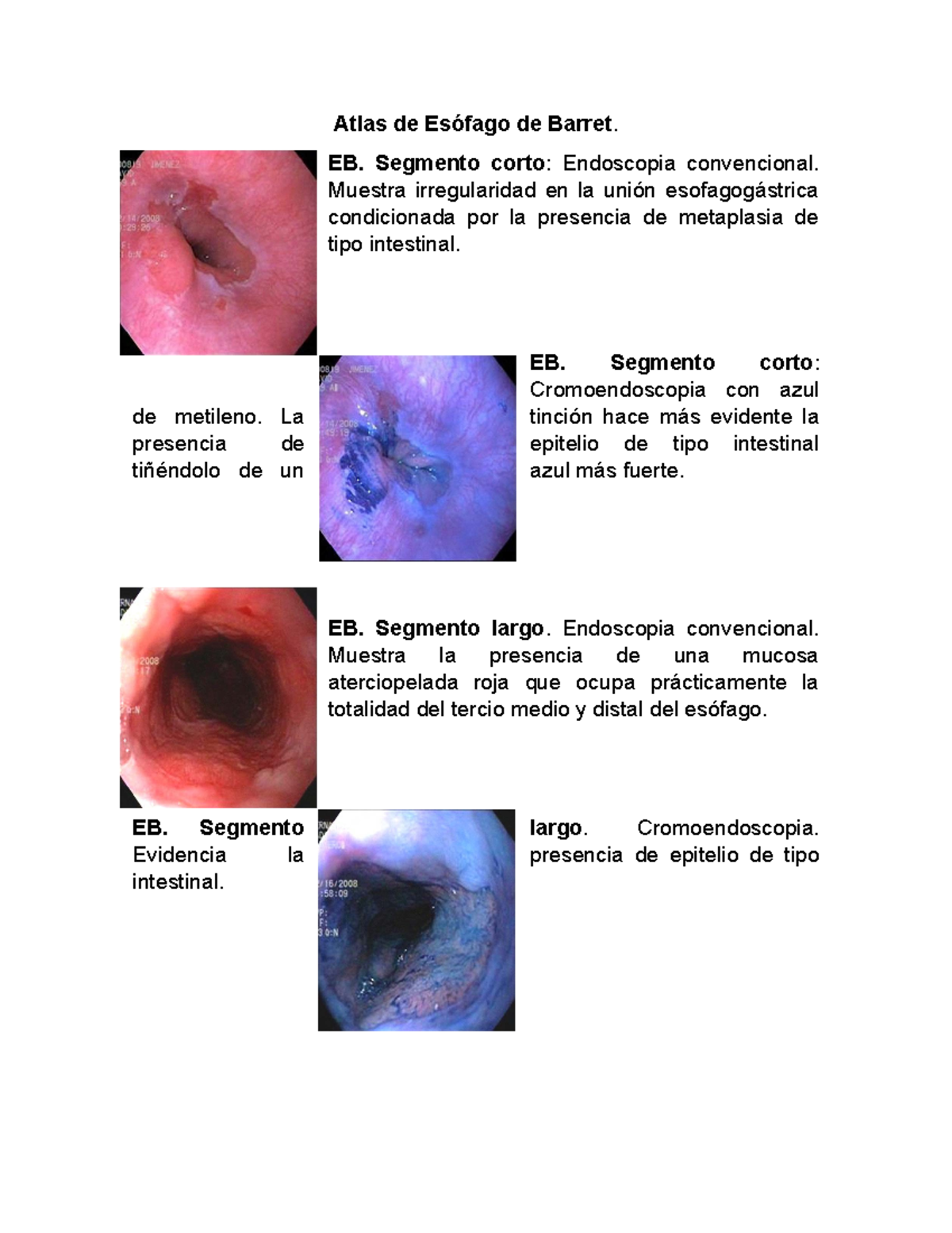 Atlas de EB - Imagenes endoscópicas de Esófago de barret - Atlas de ...