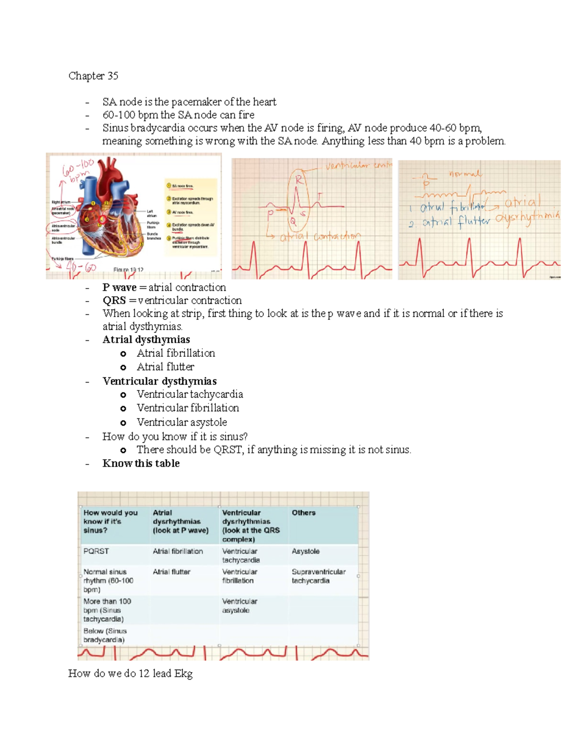 Summative 2 - Chapter 35 - SA node is the pacemaker of the heart - 60 ...