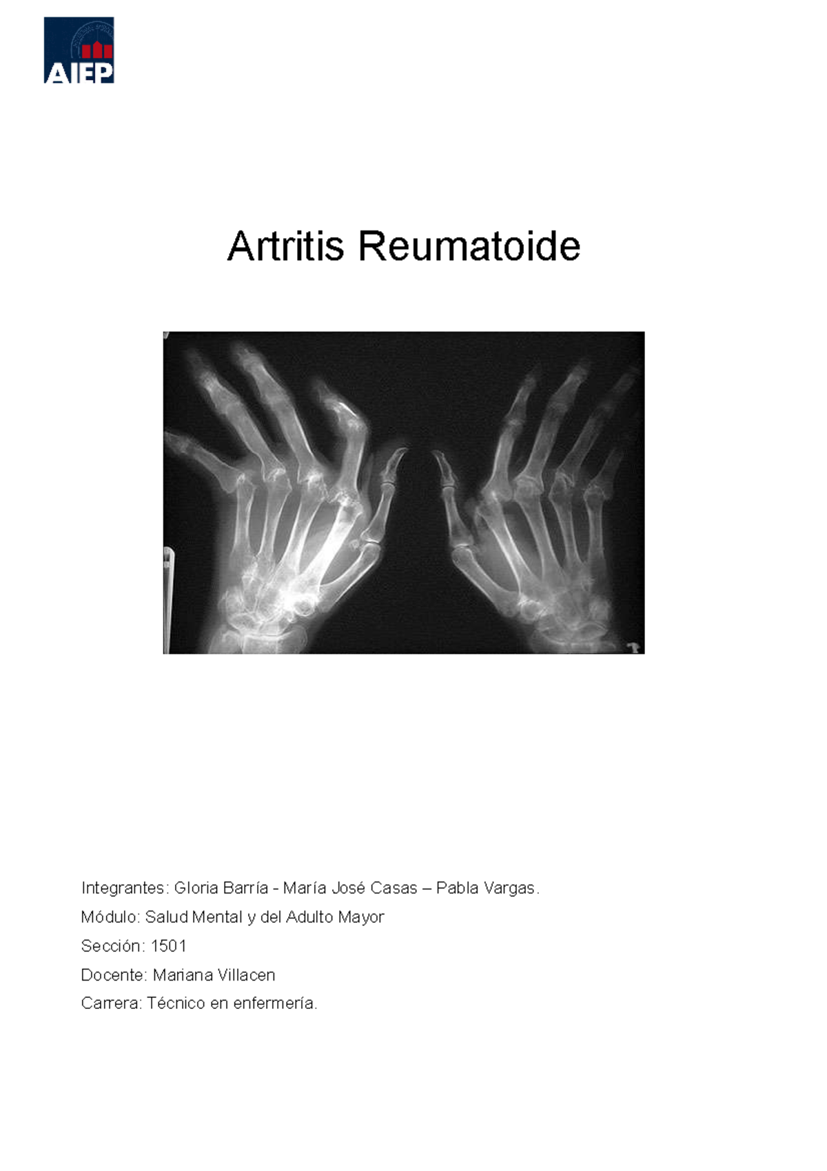 Artritis Reumatoide - Artritis Reumatoide Integrantes: Gloria Barría ...