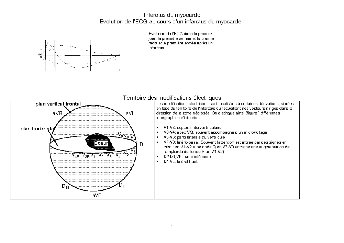 Ecg infarctus - Infarctus du myocarde Evolution de l’ECG au cours d’un ...