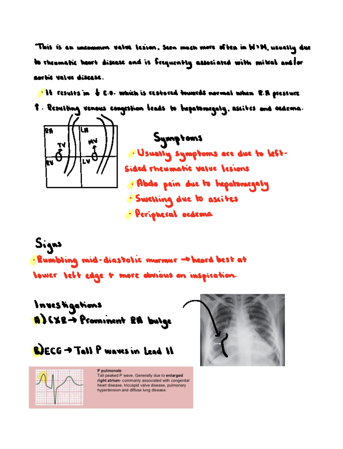 Tricuspid stenosis and regurgitation - This is an uncommon valve lesion ...