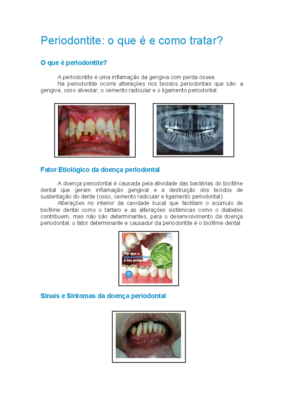 Periodontite - Na periodontite ocorre alterações nos tecidos ...